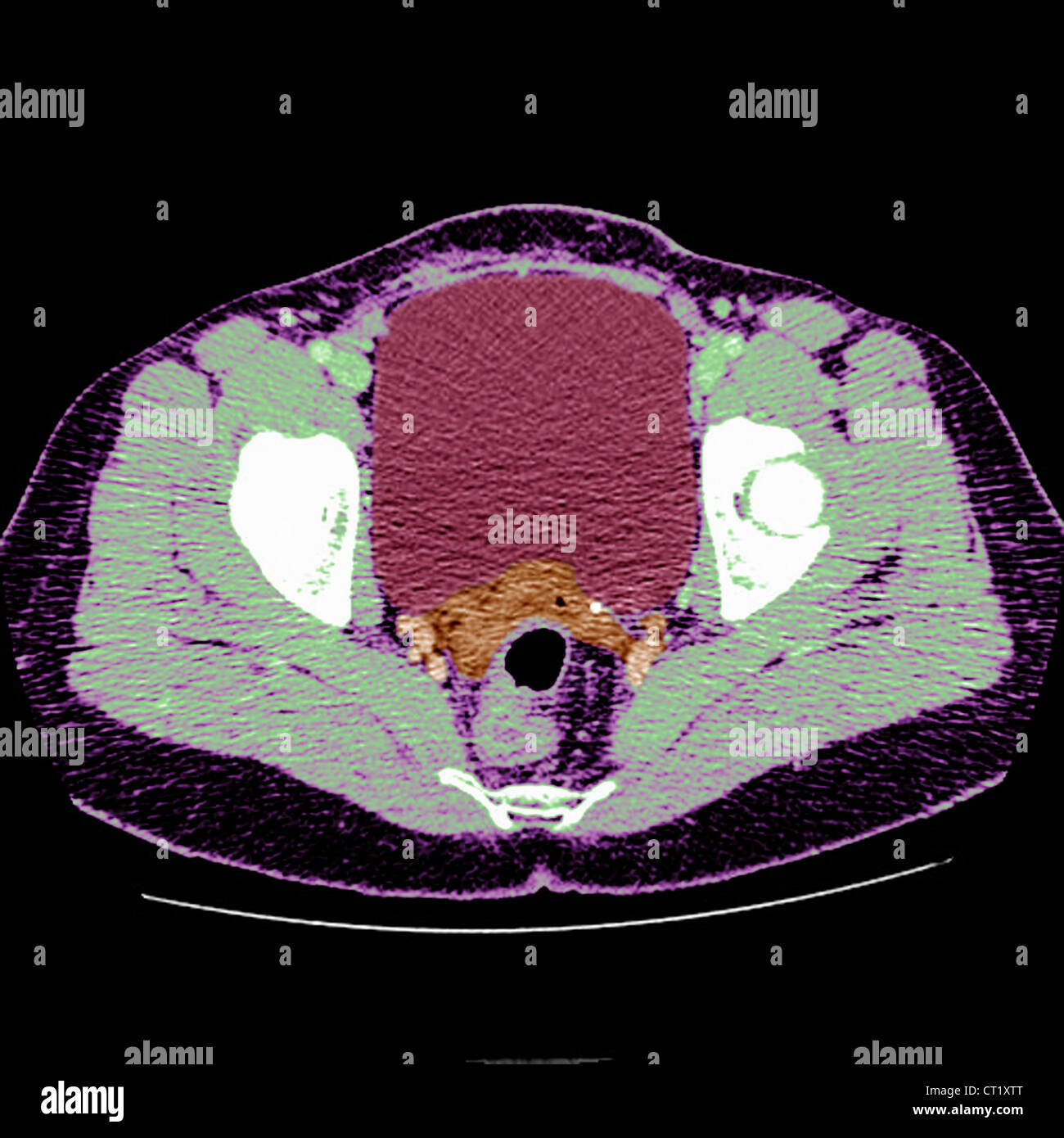 BLADDER, SCAN Stock Photo - Alamy