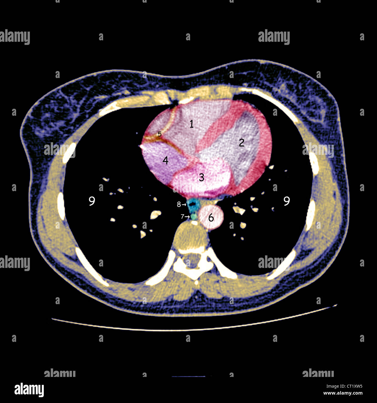 Ventricle Scan High Resolution Stock Photography and Images - Alamy