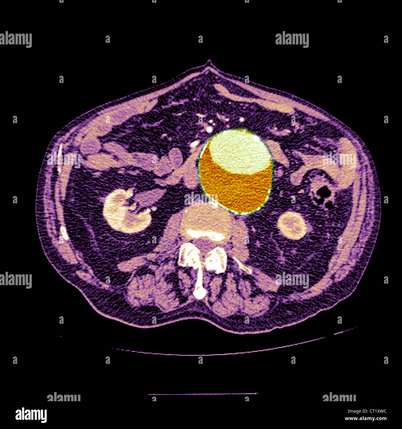 ABDOMINAL AORTA ANEURYSM, SCAN Stock Photo - Alamy