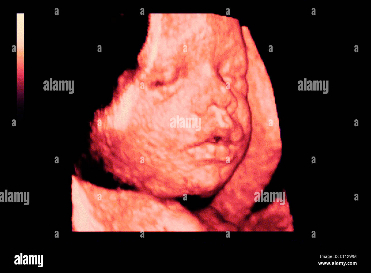 Ultrasound fetus 3 months hi-res stock photography and images - Alamy