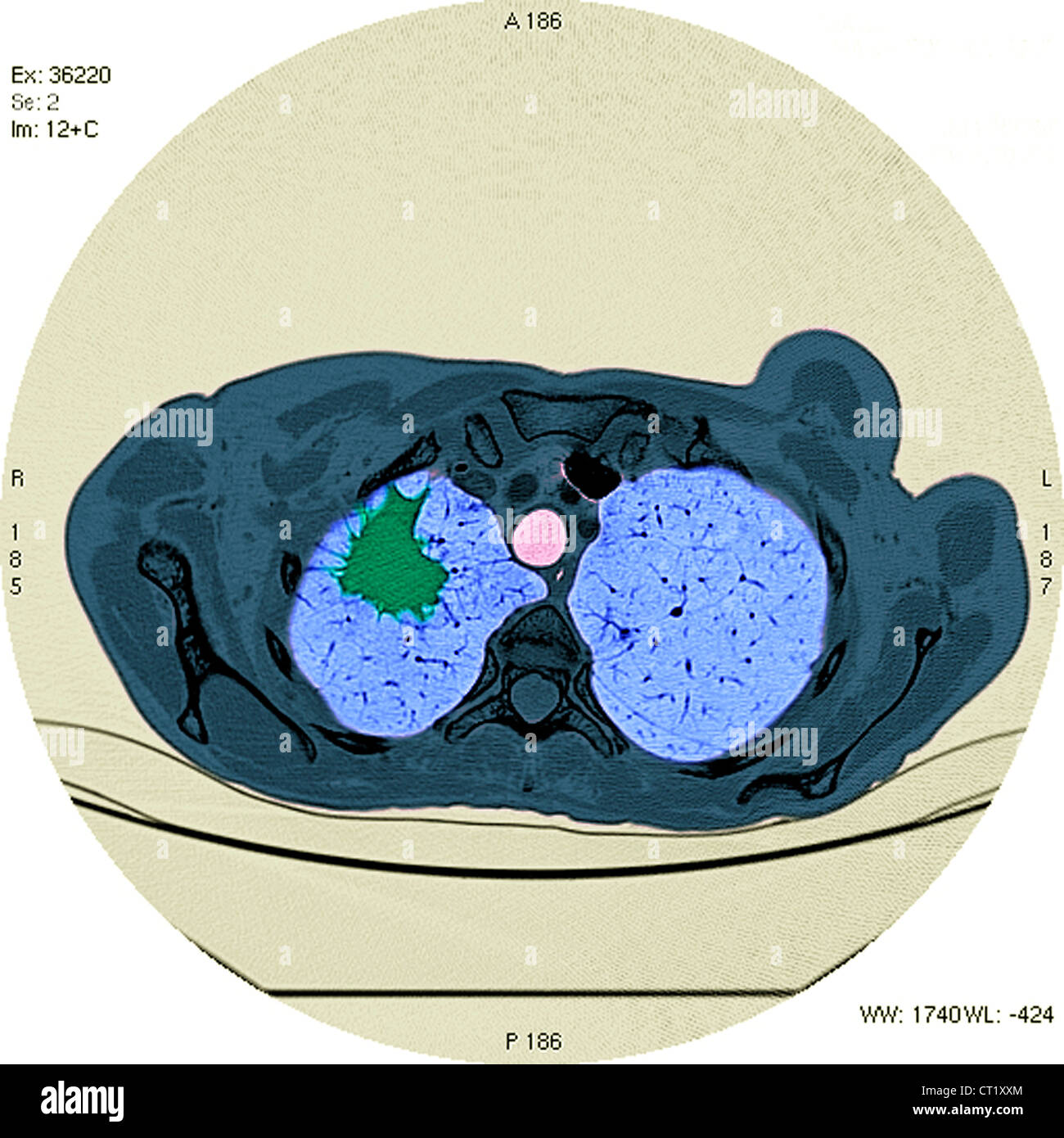 LUNG CANCER, SCAN Stock Photo - Alamy