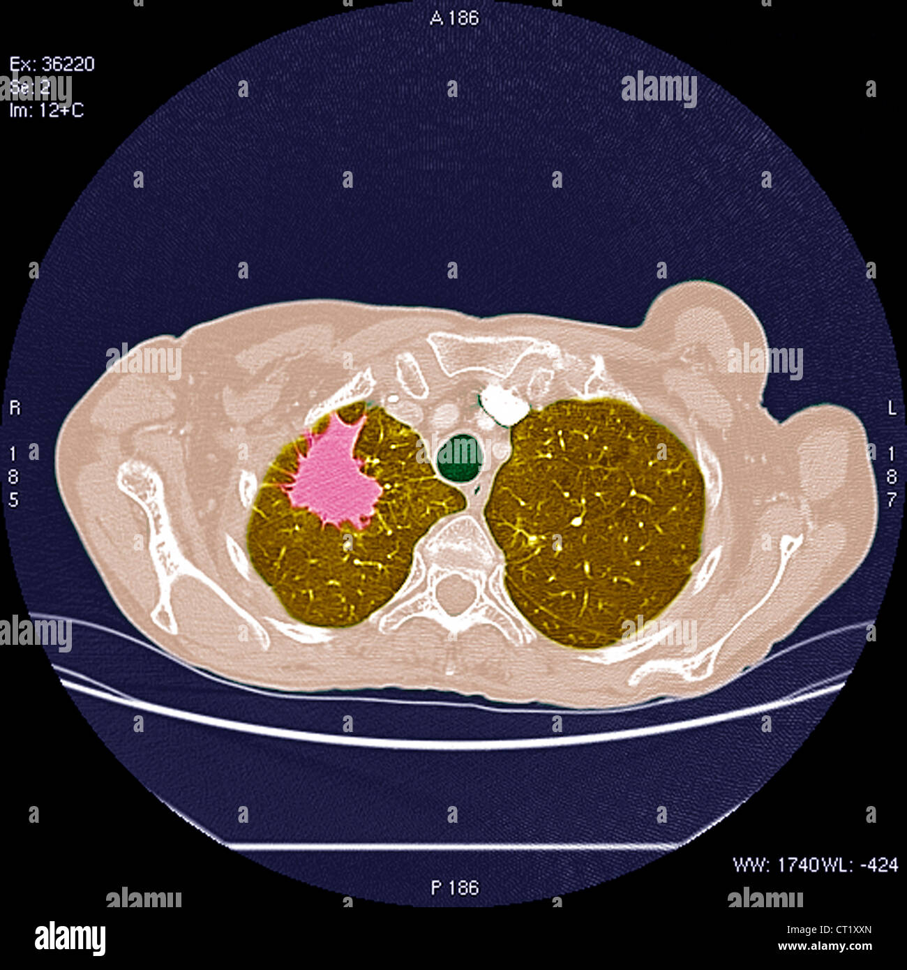 LUNG CANCER, SCAN Stock Photo - Alamy