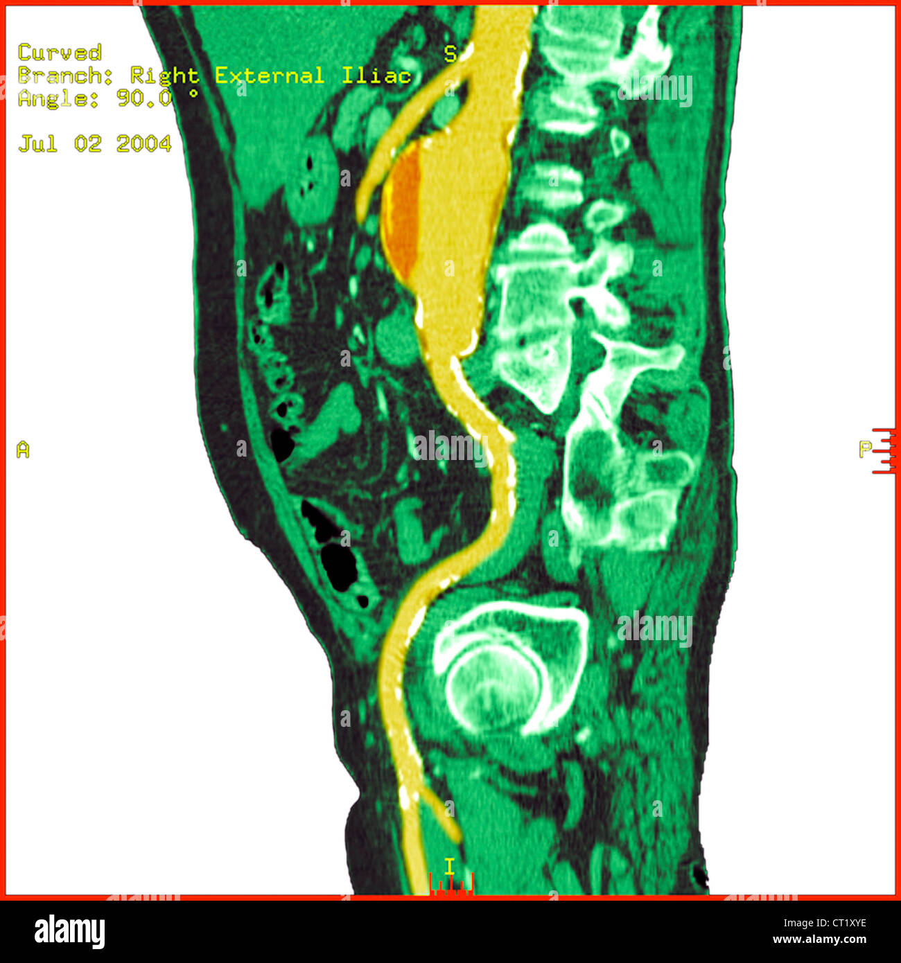 ABDOMINAL AORTA ANEURYSM, SCAN Stock Photo - Alamy