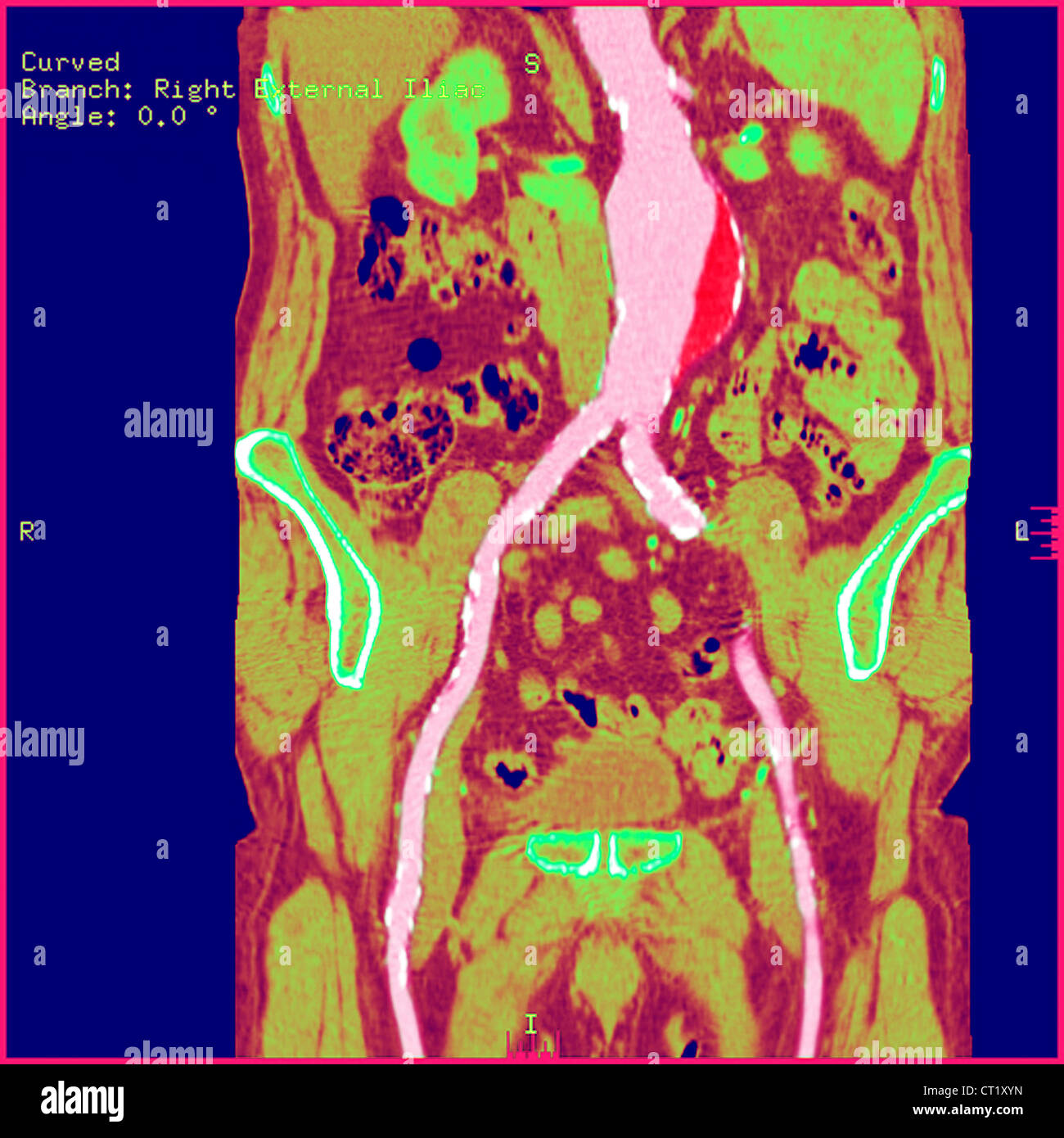 Abdominal aortic aneurysm hi-res stock photography and images - Alamy
