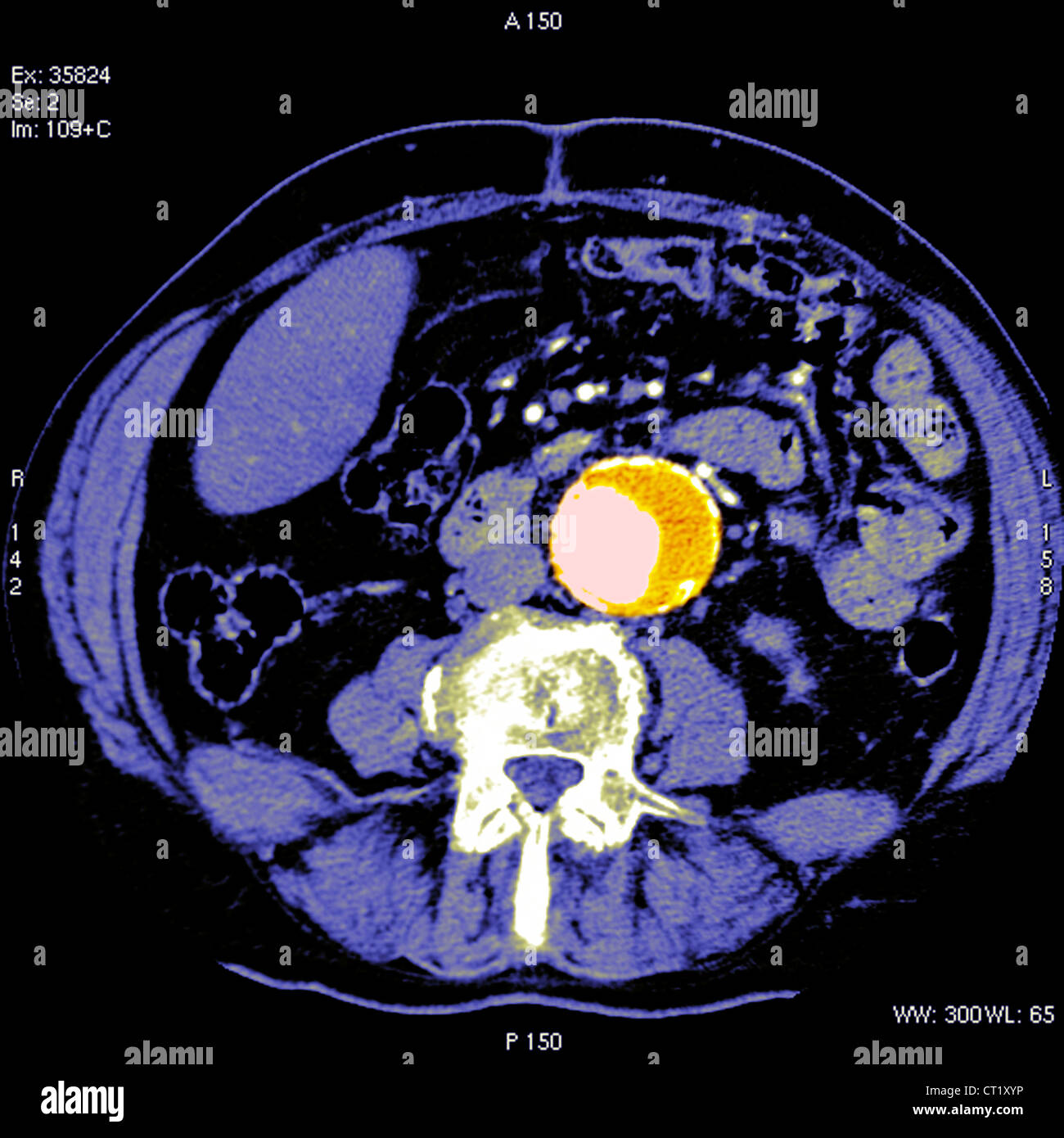 ABDOMINAL AORTA ANEURYSM, SCAN Stock Photo - Alamy