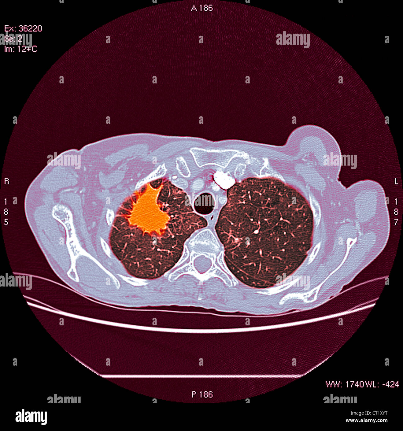 LUNG CANCER, SCAN Stock Photo - Alamy