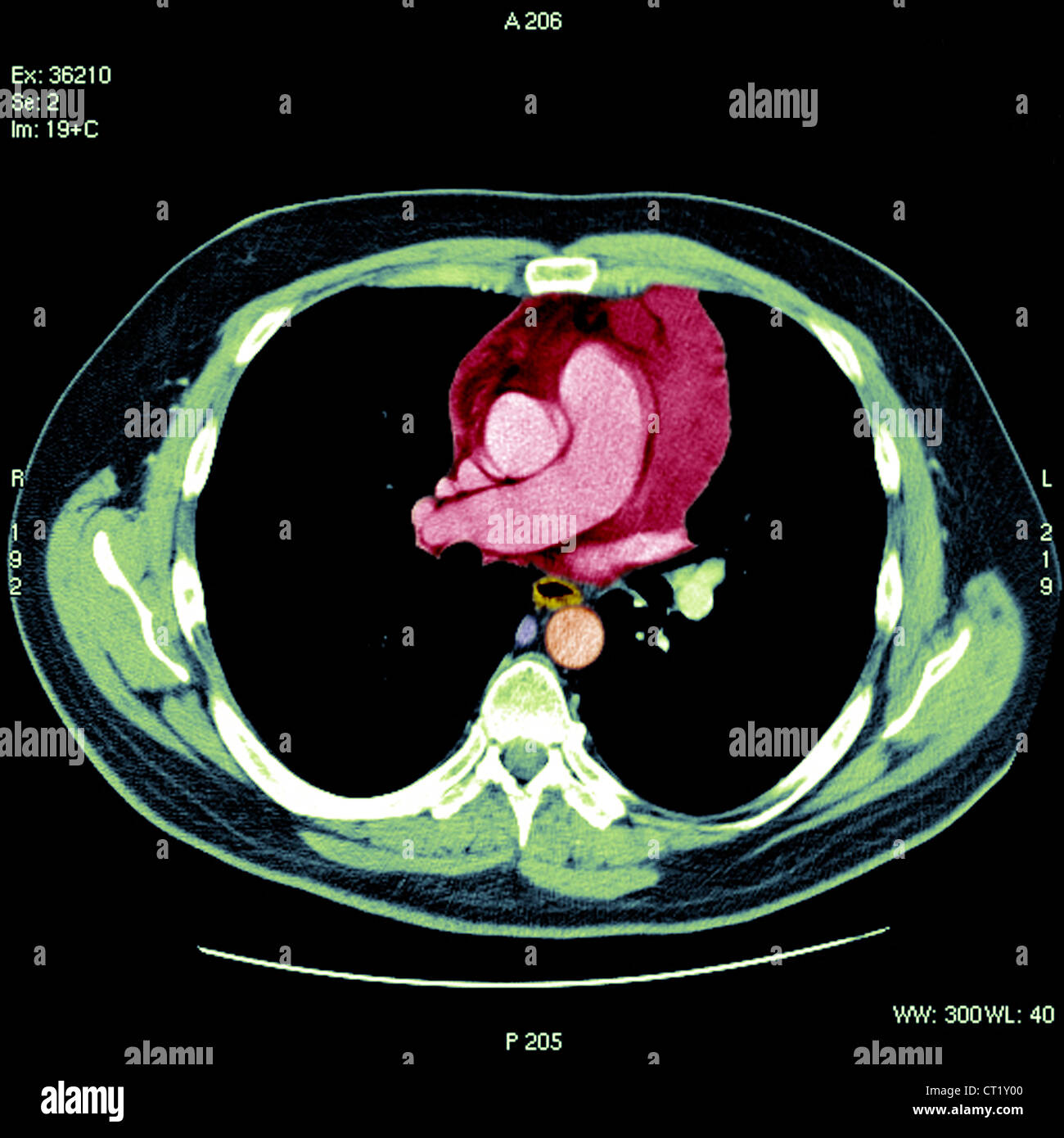 Cat scan heart hi-res stock photography and images - Alamy
