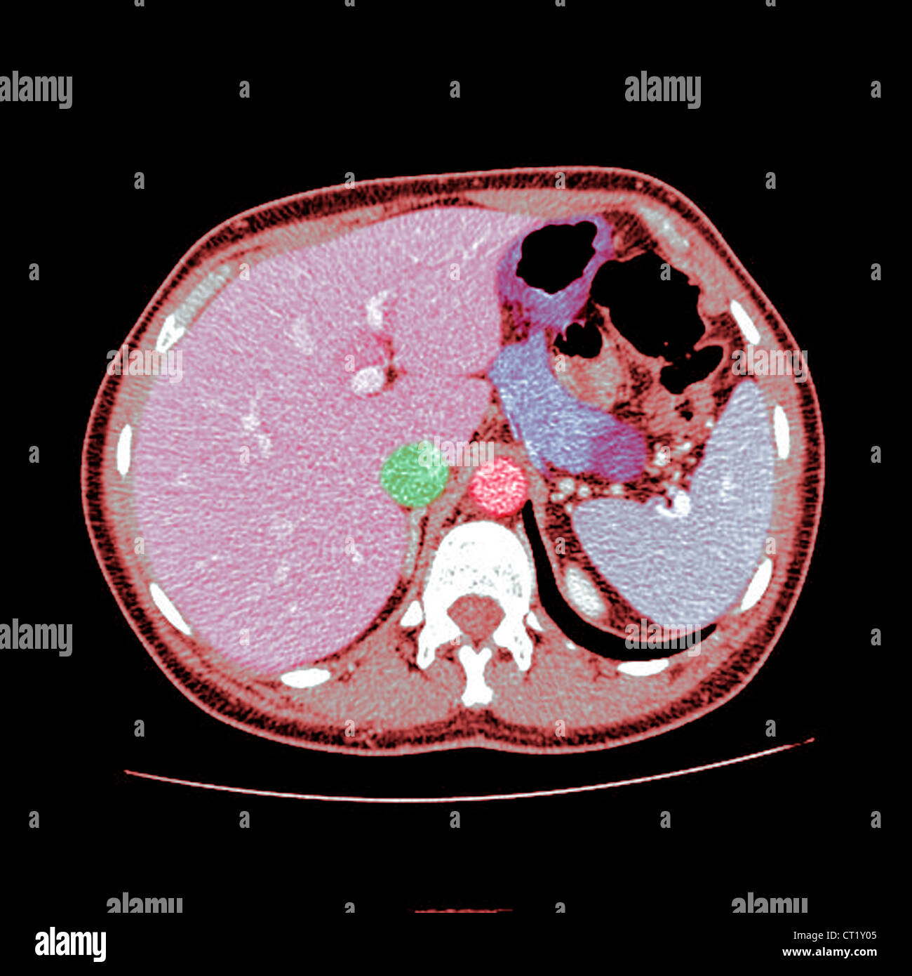 Normal liver scan hi-res stock photography and images - Alamy