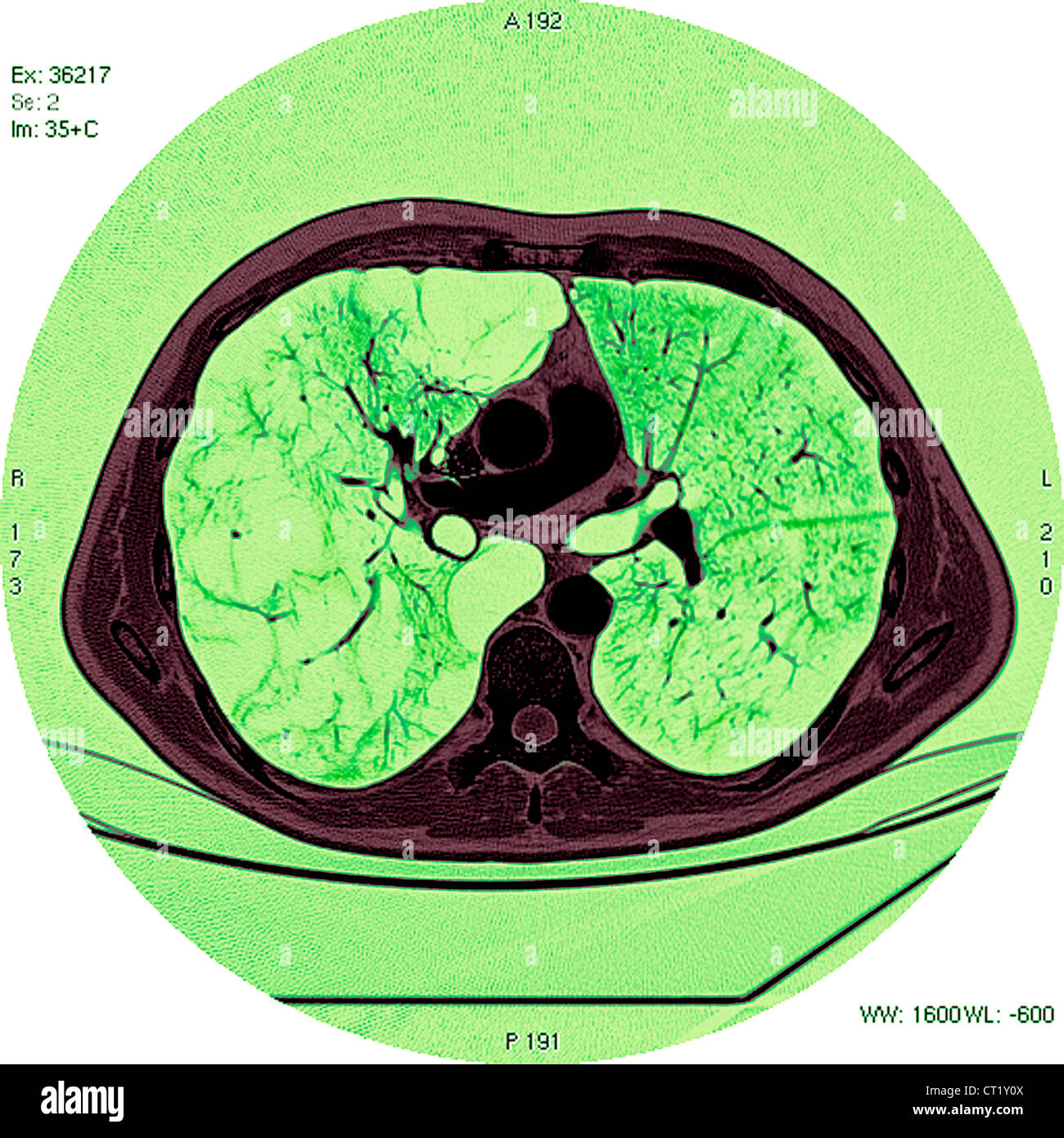 LUNG SCAN FOR EMPHYSEMA Stock Photo - Alamy