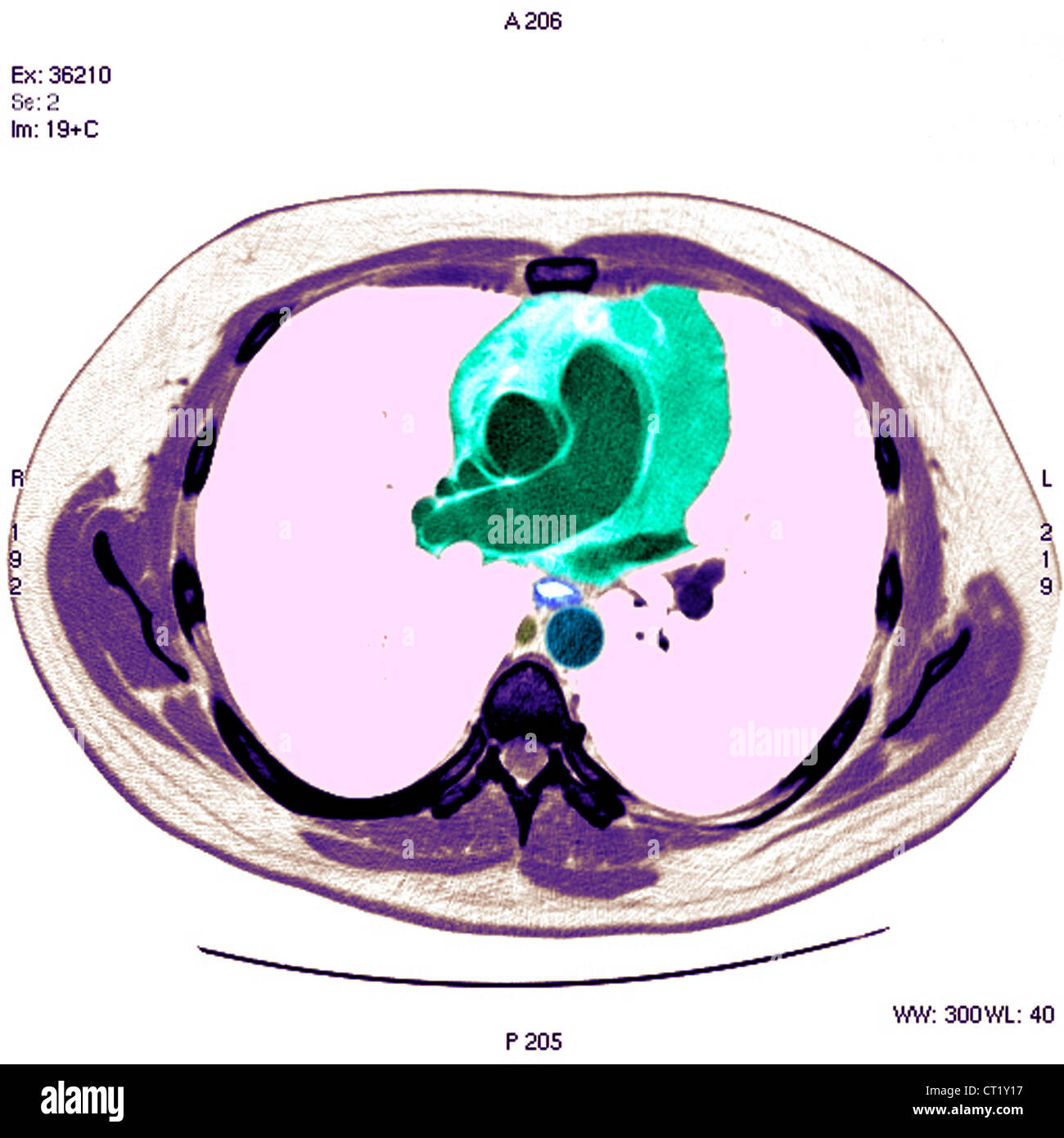 Cat scan heart hi-res stock photography and images - Alamy