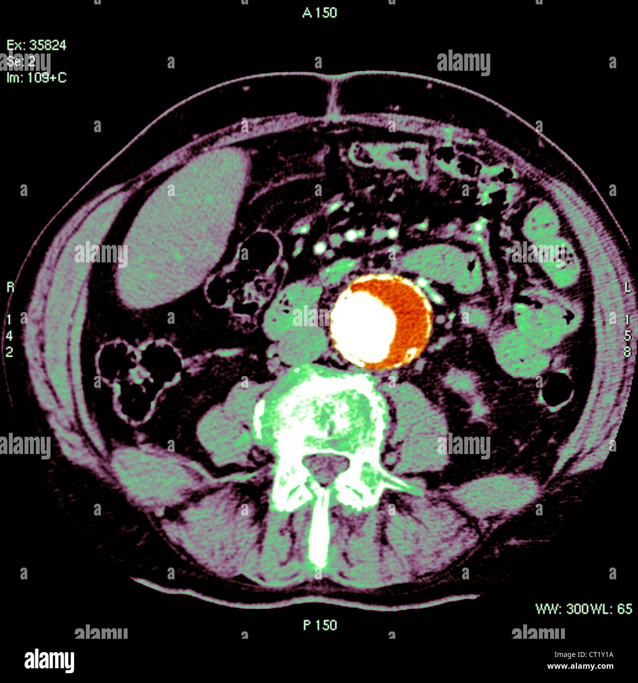 Abdominal aortic aneurysm hi-res stock photography and images - Alamy