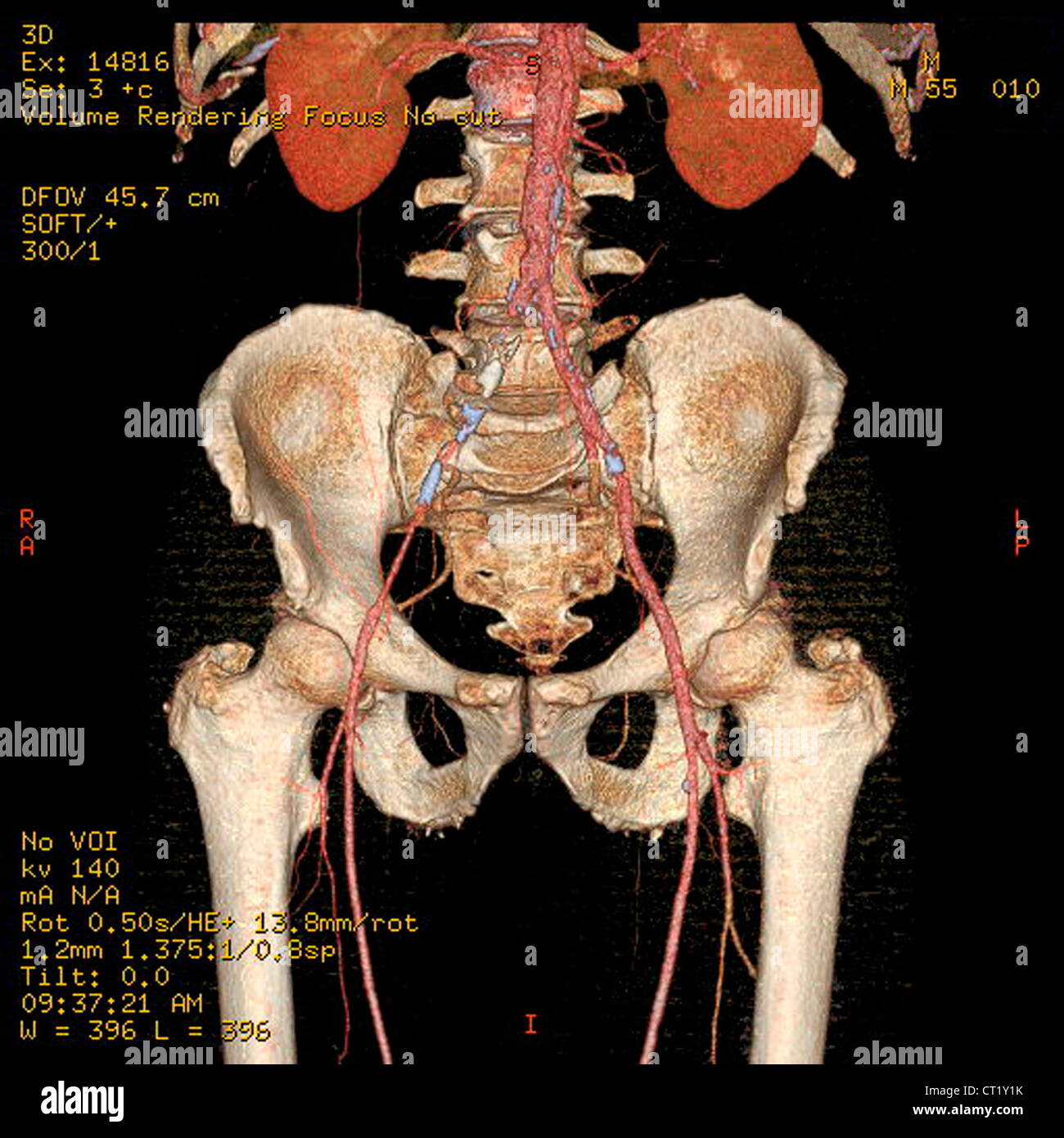 Common iliac artery hi-res stock photography and images - Alamy