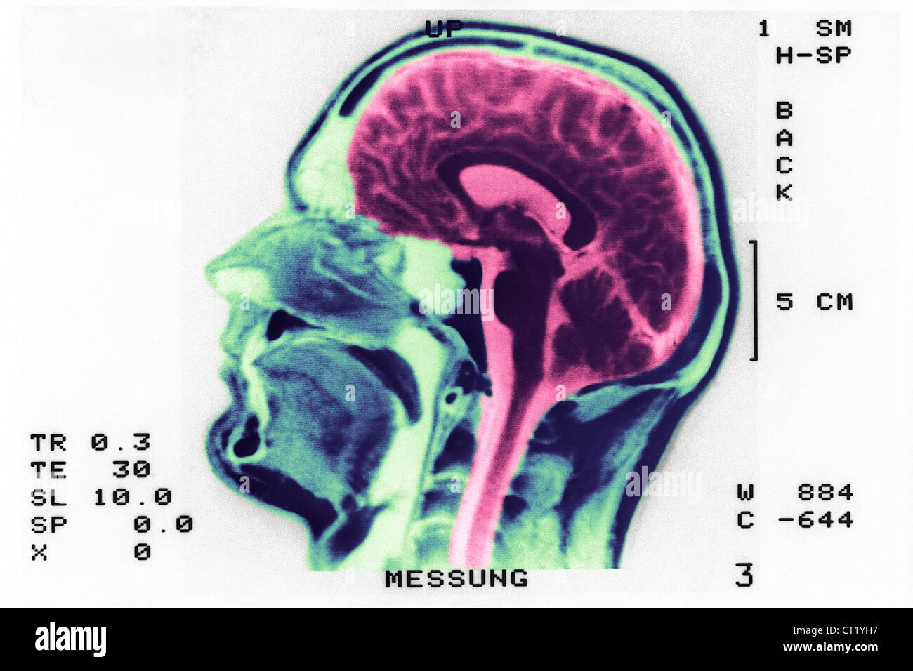 Normal brain scan hi-res stock photography and images - Alamy