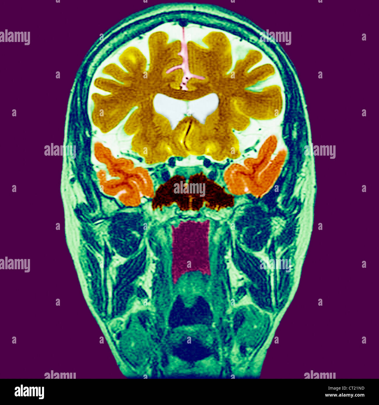 Medial longitudinal fissures hi-res stock photography and images - Alamy