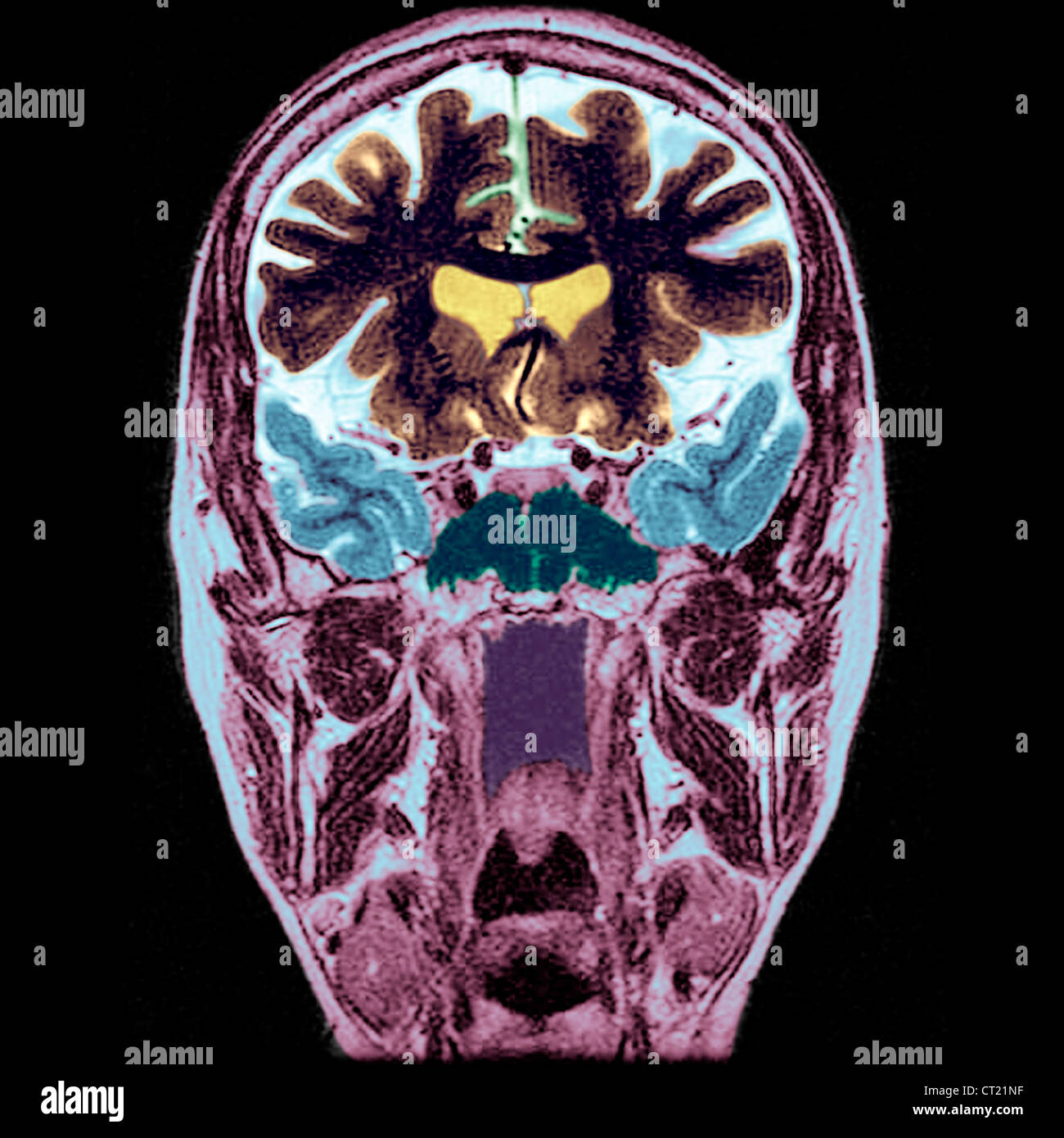 Medial longitudinal fissures hi-res stock photography and images - Alamy
