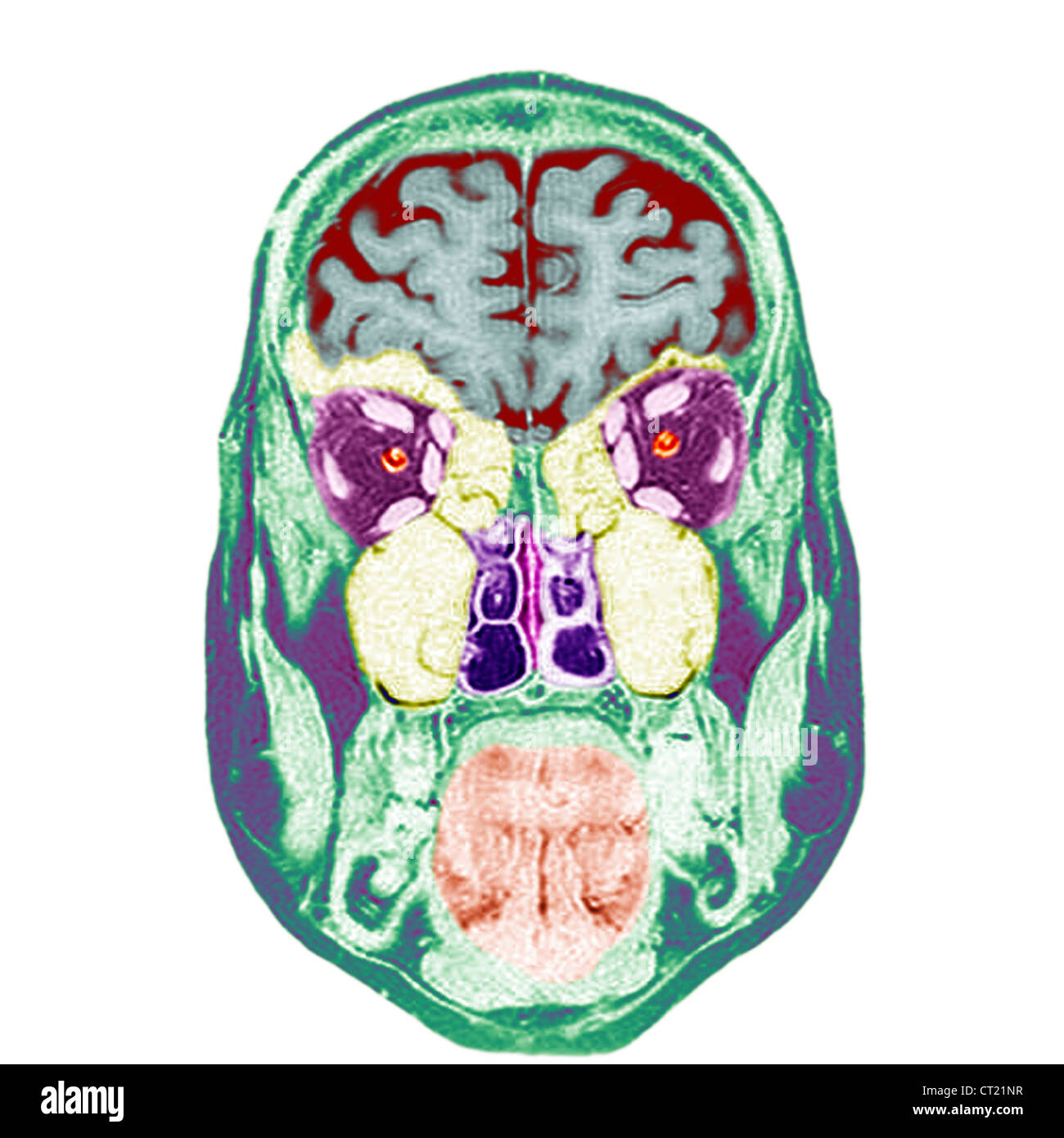 Lingual septum hi-res stock photography and images - Alamy