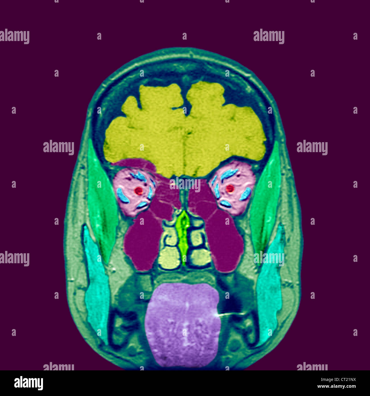 Mri sinuses nasal cavity hi-res stock photography and images - Alamy