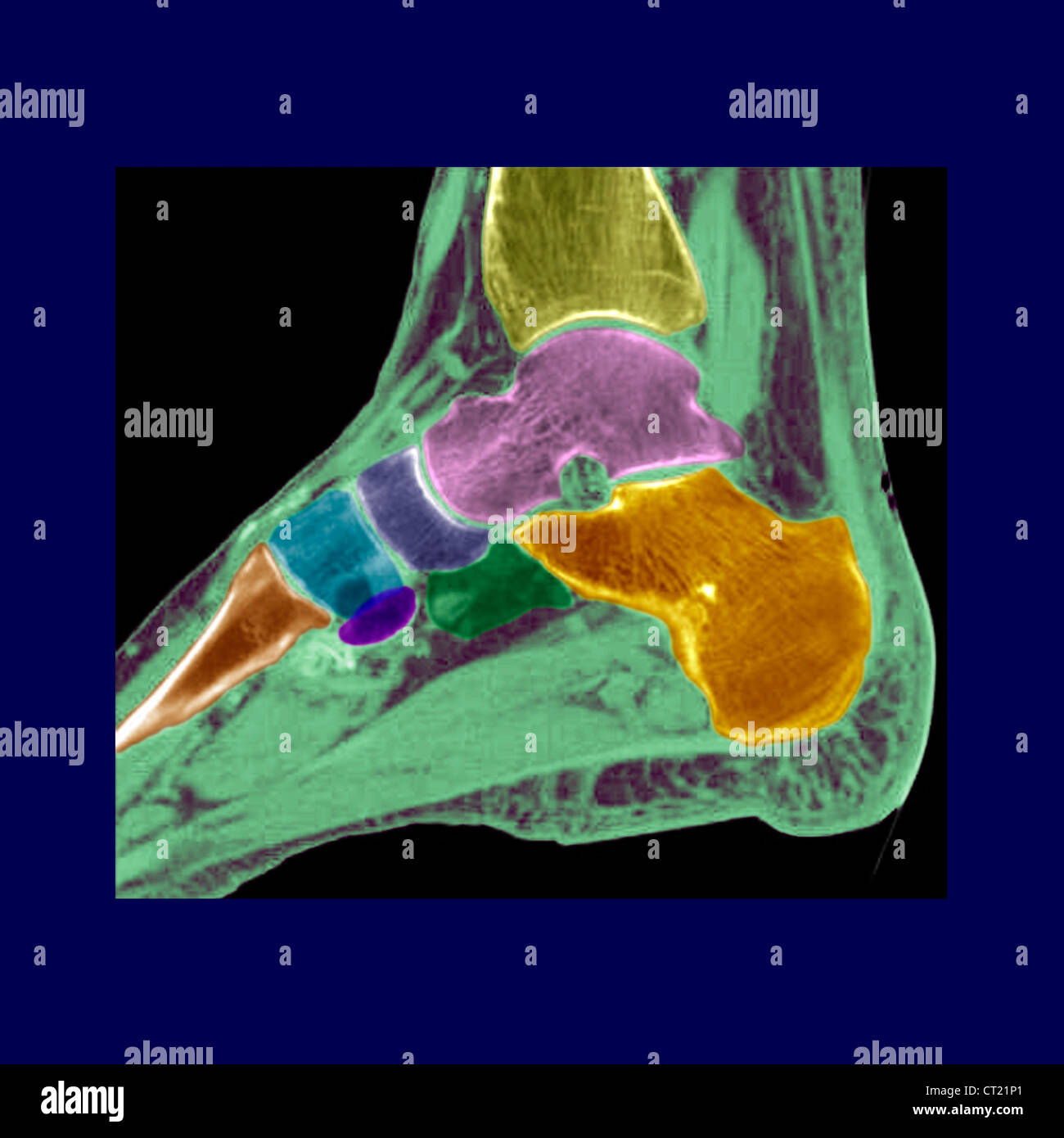 Os tarsi tibiale hi-res stock photography and images - Alamy