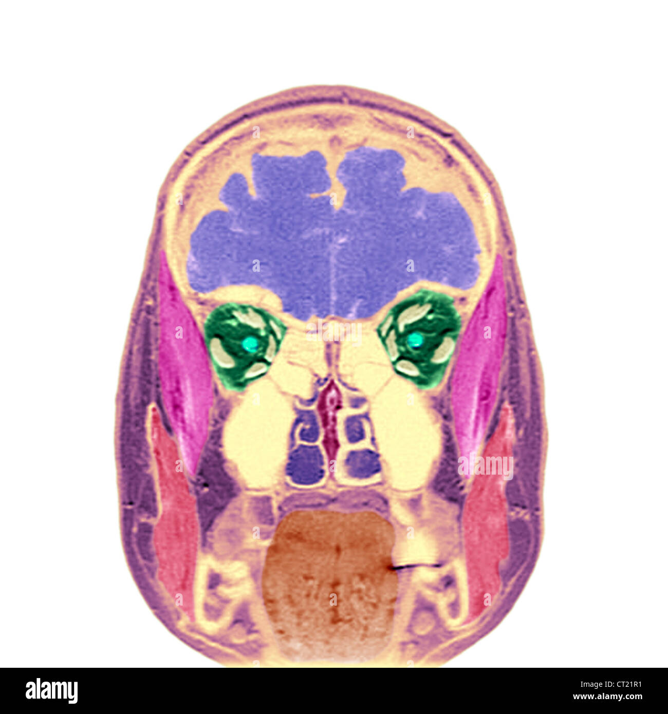 Mri sinuses nasal cavity hi-res stock photography and images - Alamy
