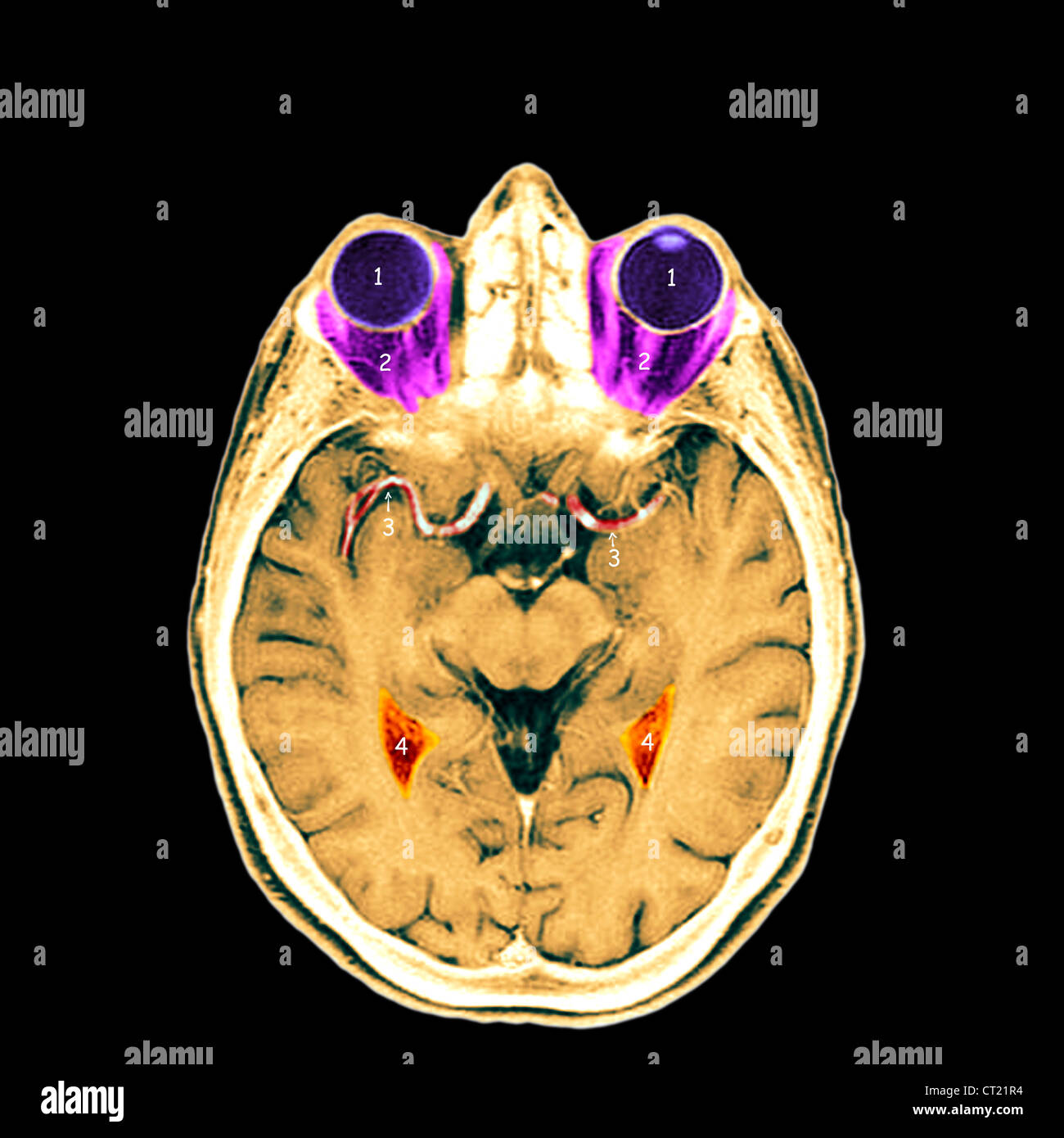 HEAD, MRI Stock Photo: 49217816 - Alamy