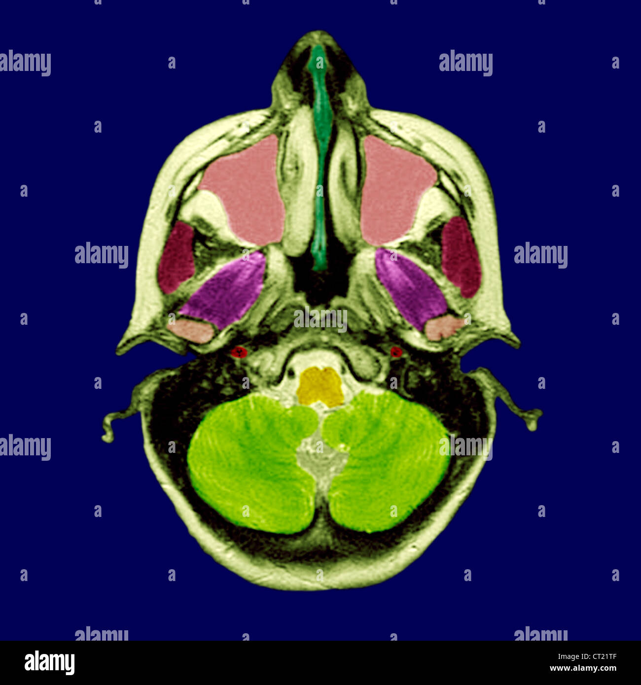 Musculature mri hi-res stock photography and images - Alamy