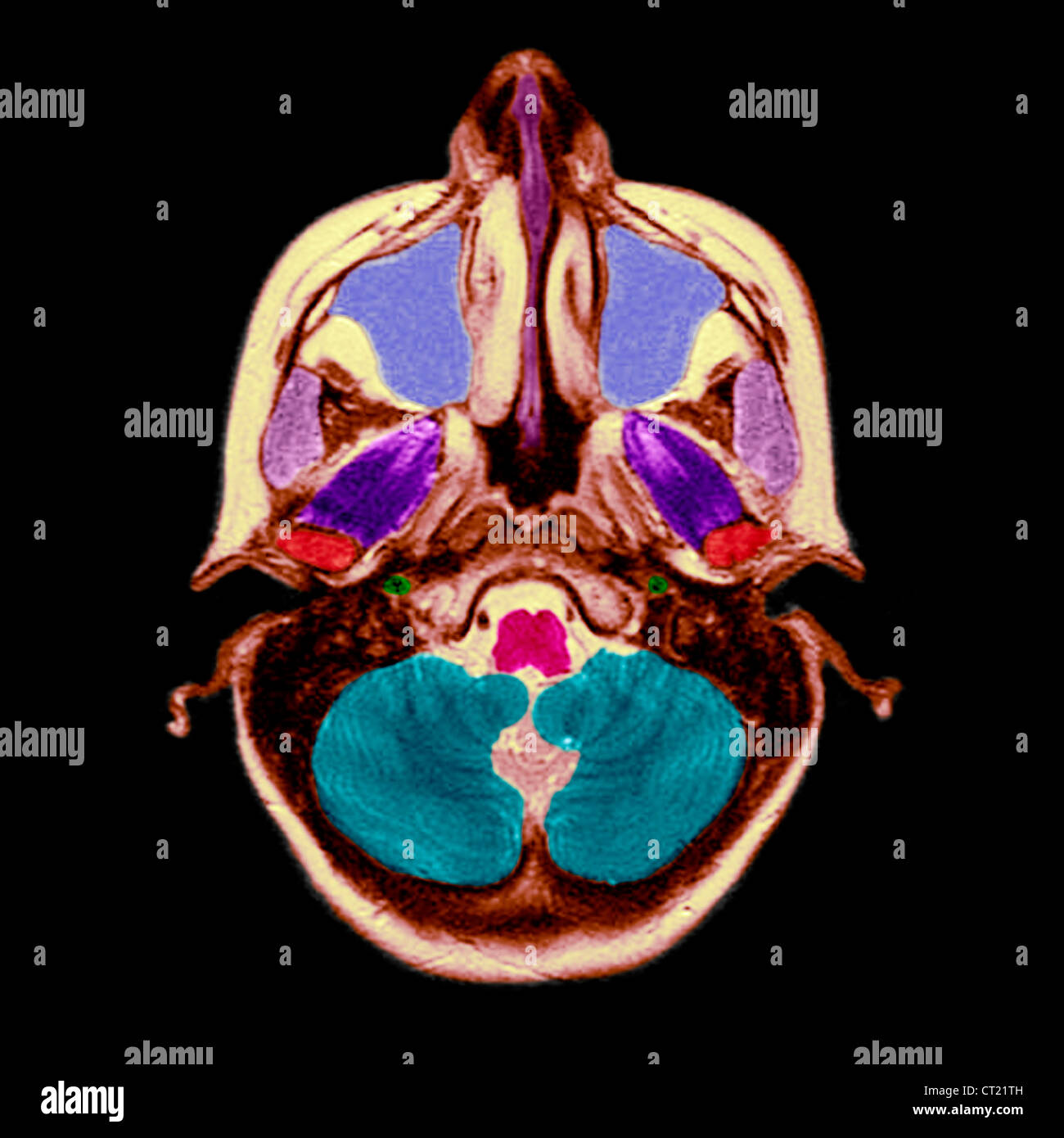 Musculature mri hi-res stock photography and images - Alamy