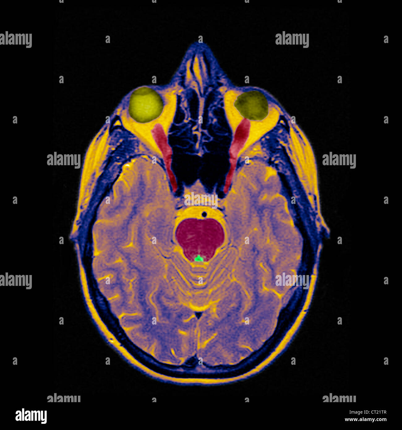 Optic nerve mri hi-res stock photography and images - Alamy