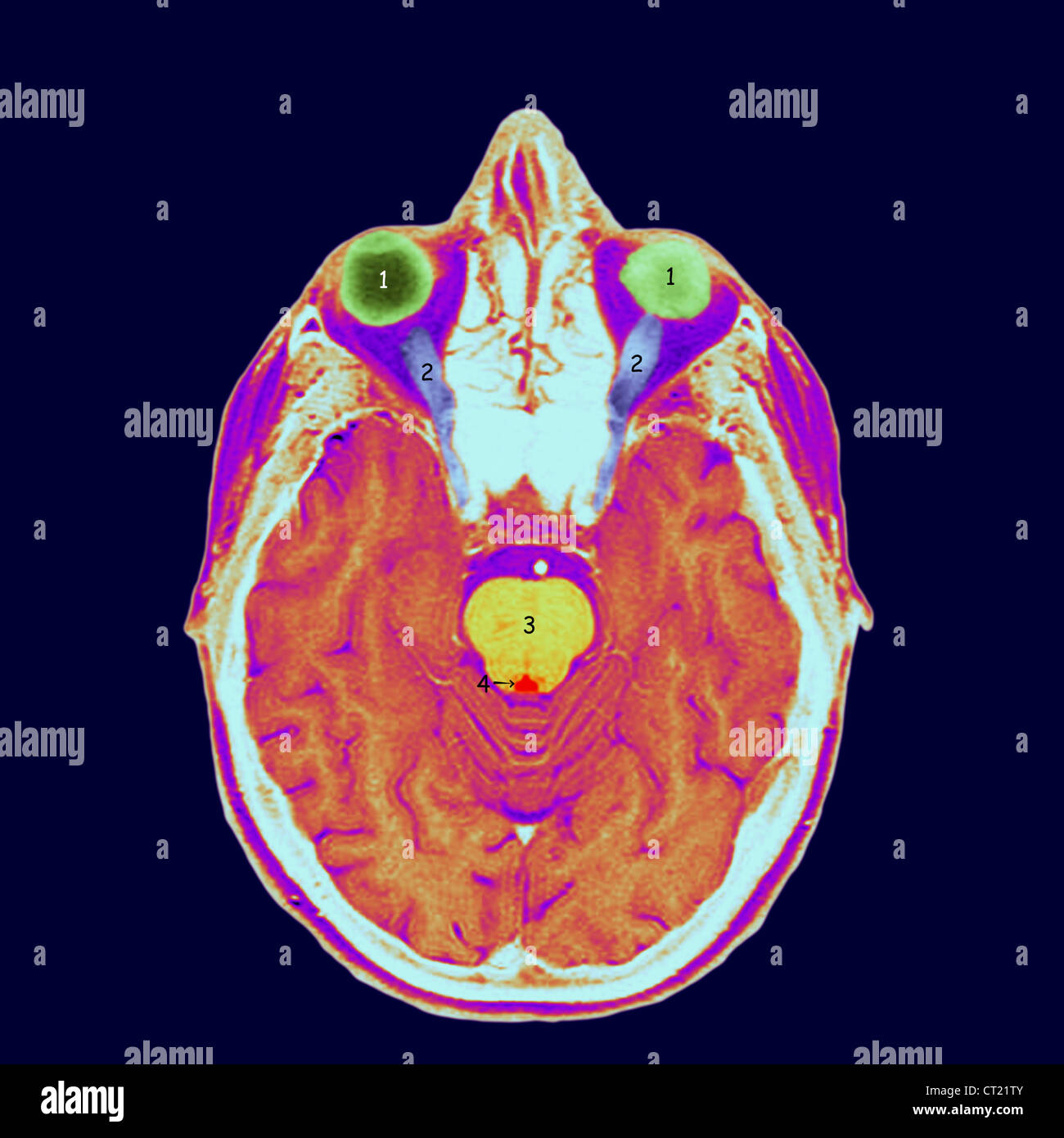 Bulbus cerebri hi-res stock photography and images - Alamy