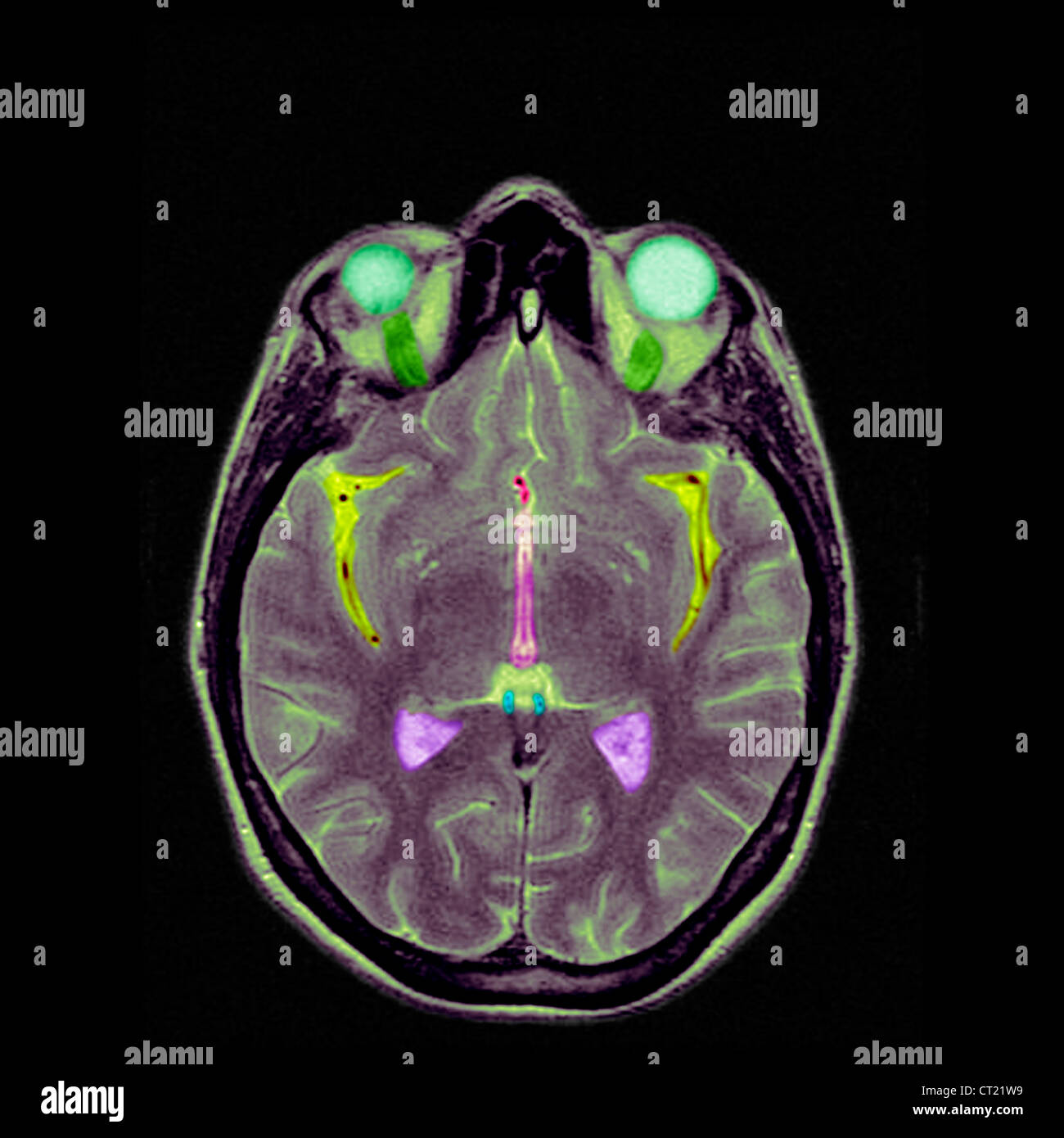 Habenular commissure hi-res stock photography and images - Alamy