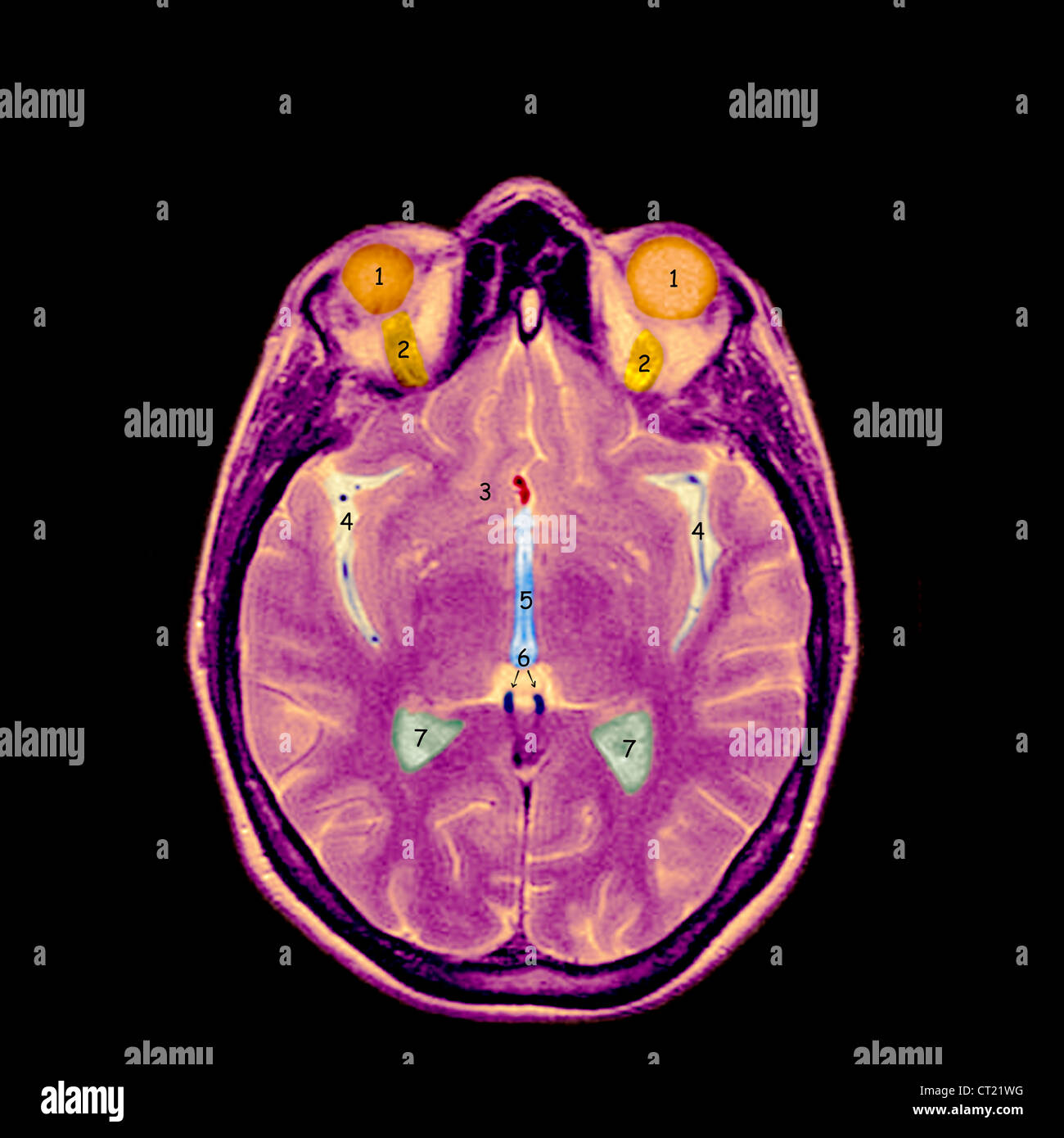Habenular trigone hi-res stock photography and images - Alamy