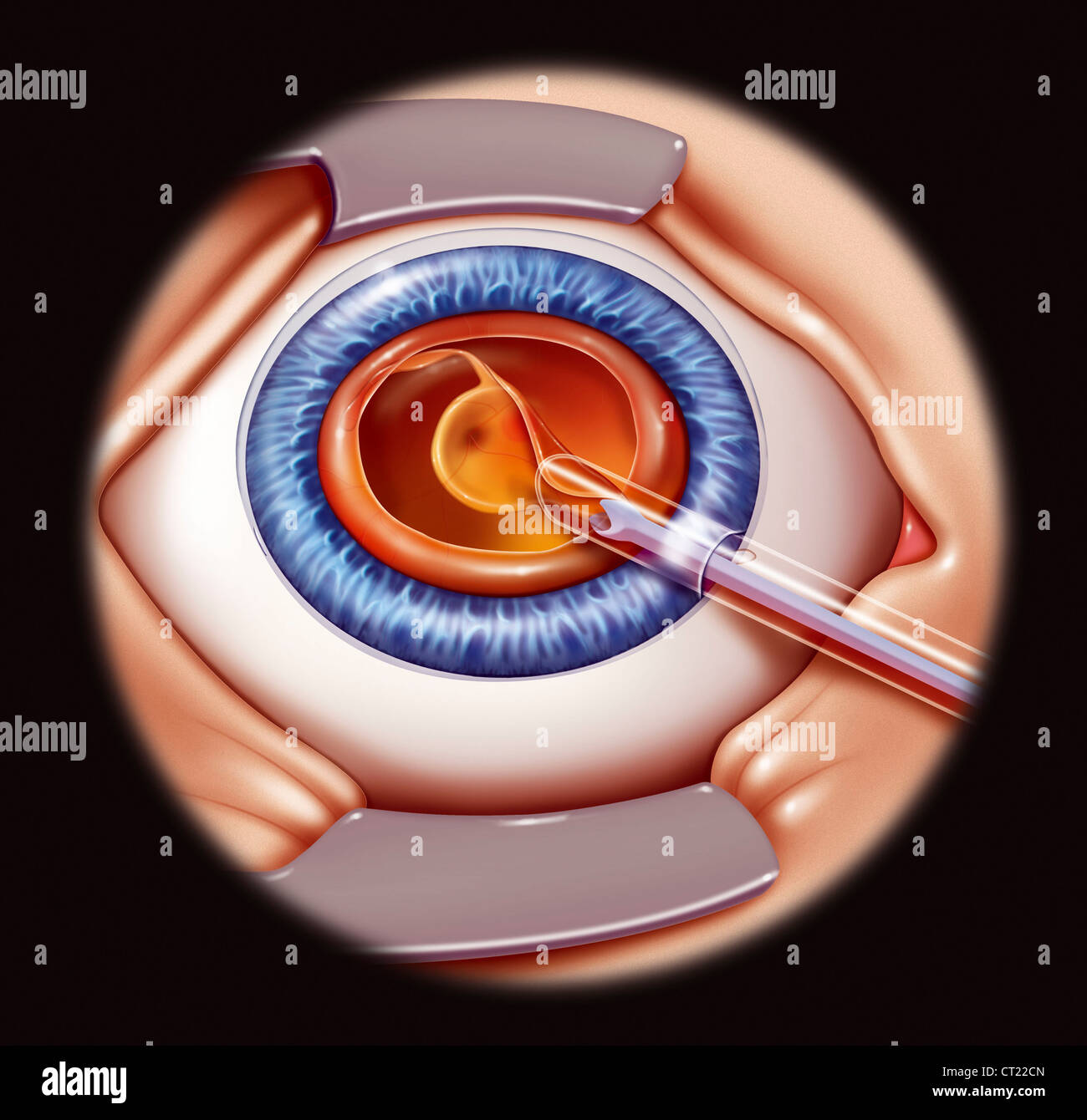 CATARACT SURGERY, DRAWING Stock Photo - Alamy