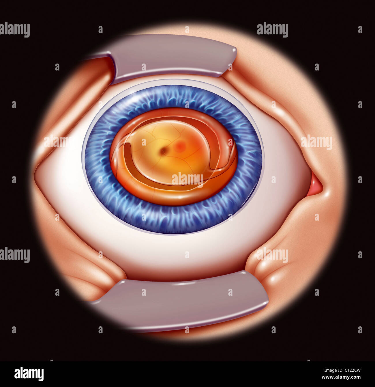 CATARACT SURGERY, DRAWING Stock Photo - Alamy