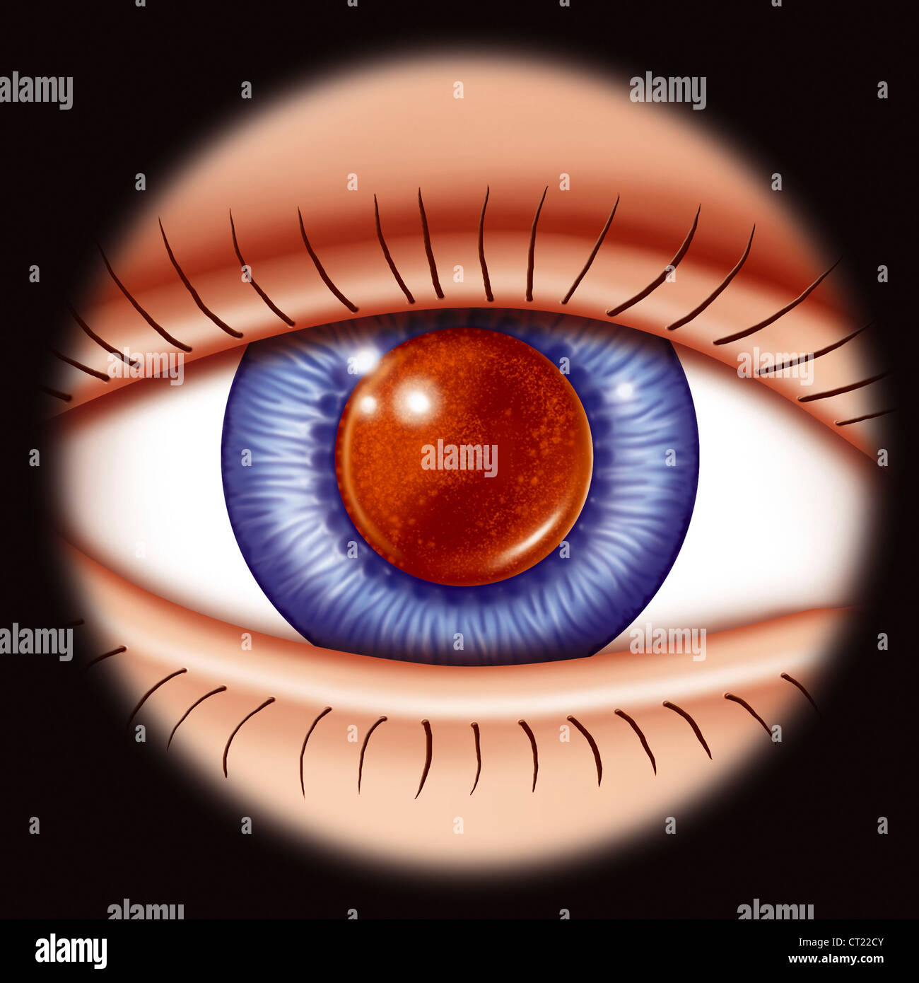 Cataract Subcapsular Posterior Cataract High Resolution Stock ...