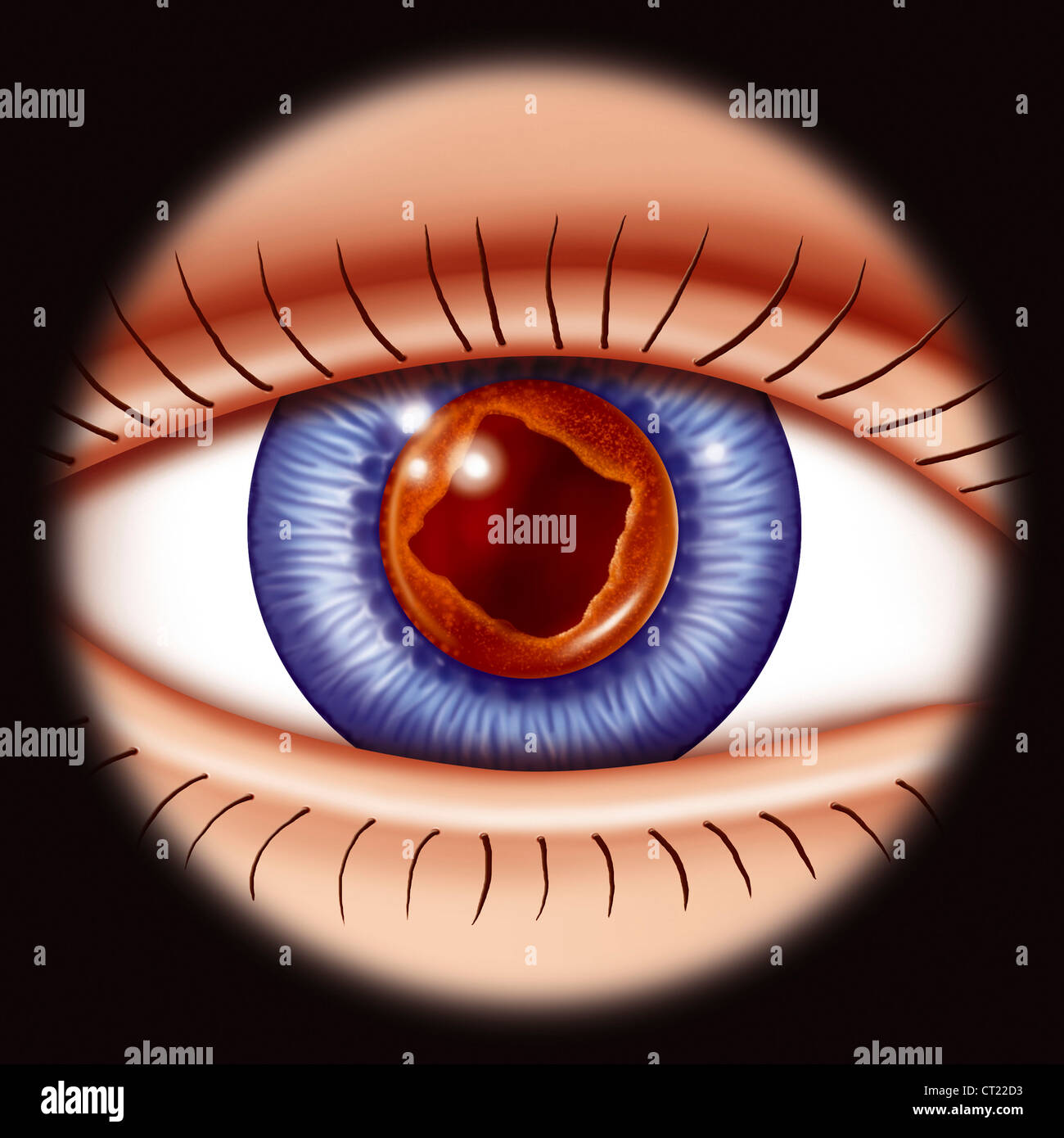 CATARACT SURGERY, DRAWING Stock Photo - Alamy