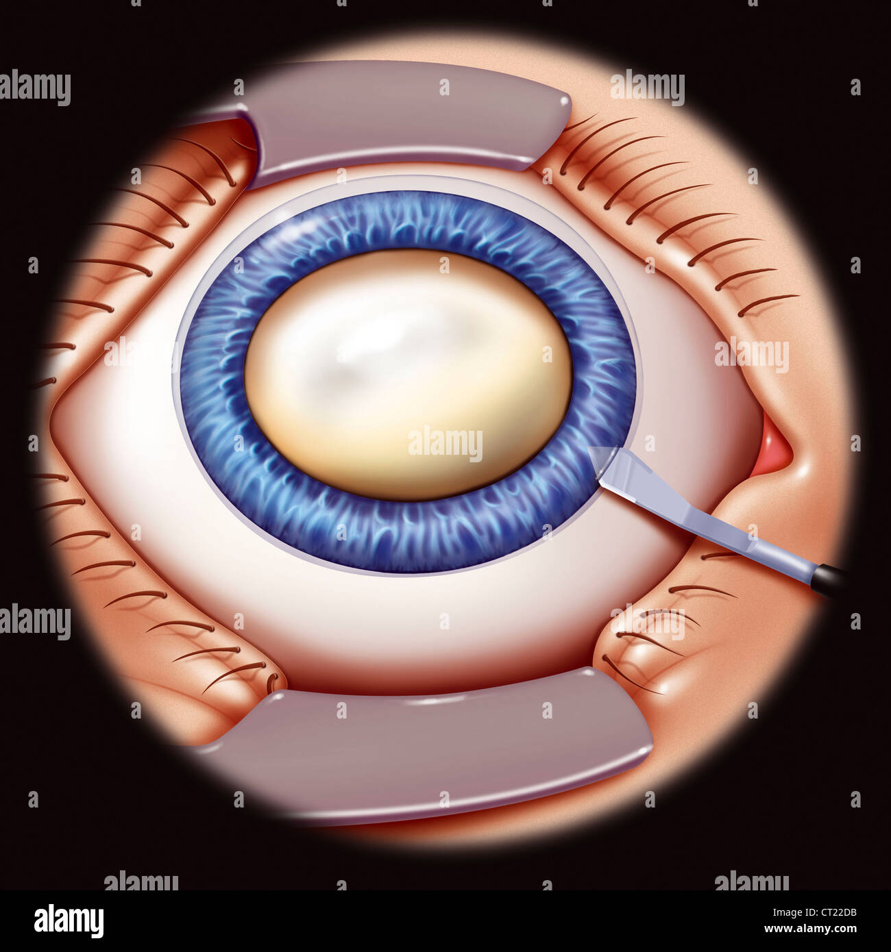 CATARACT SURGERY, DRAWING Stock Photo - Alamy