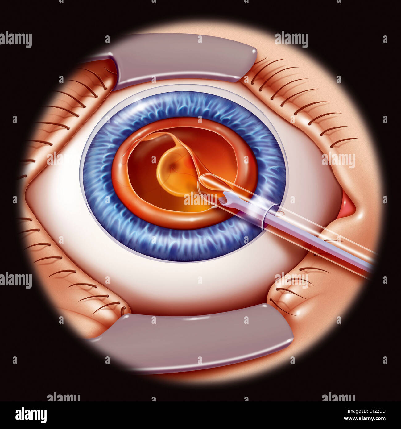 CATARACT SURGERY, DRAWING Stock Photo - Alamy
