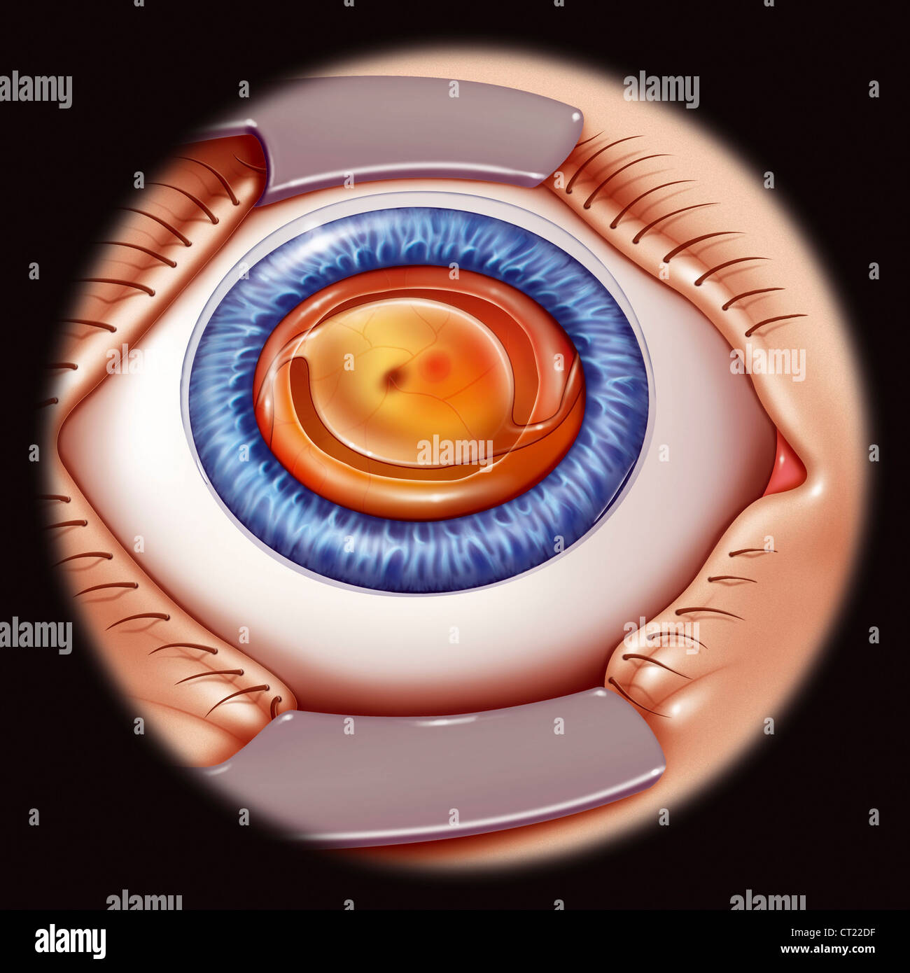 CATARACT SURGERY, DRAWING Stock Photo - Alamy