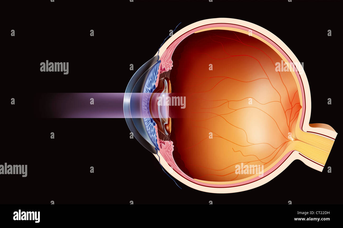 CATARACT SURGERY, DRAWING Stock Photo - Alamy