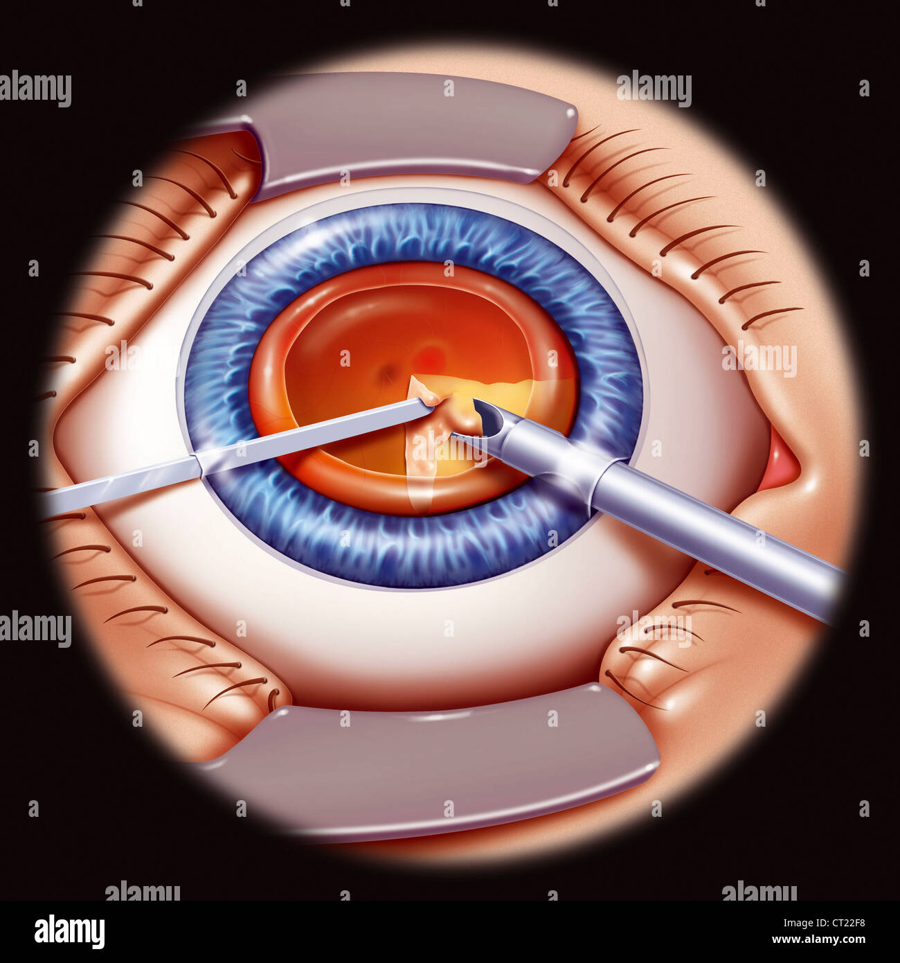 CATARACT SURGERY, DRAWING Stock Photo - Alamy