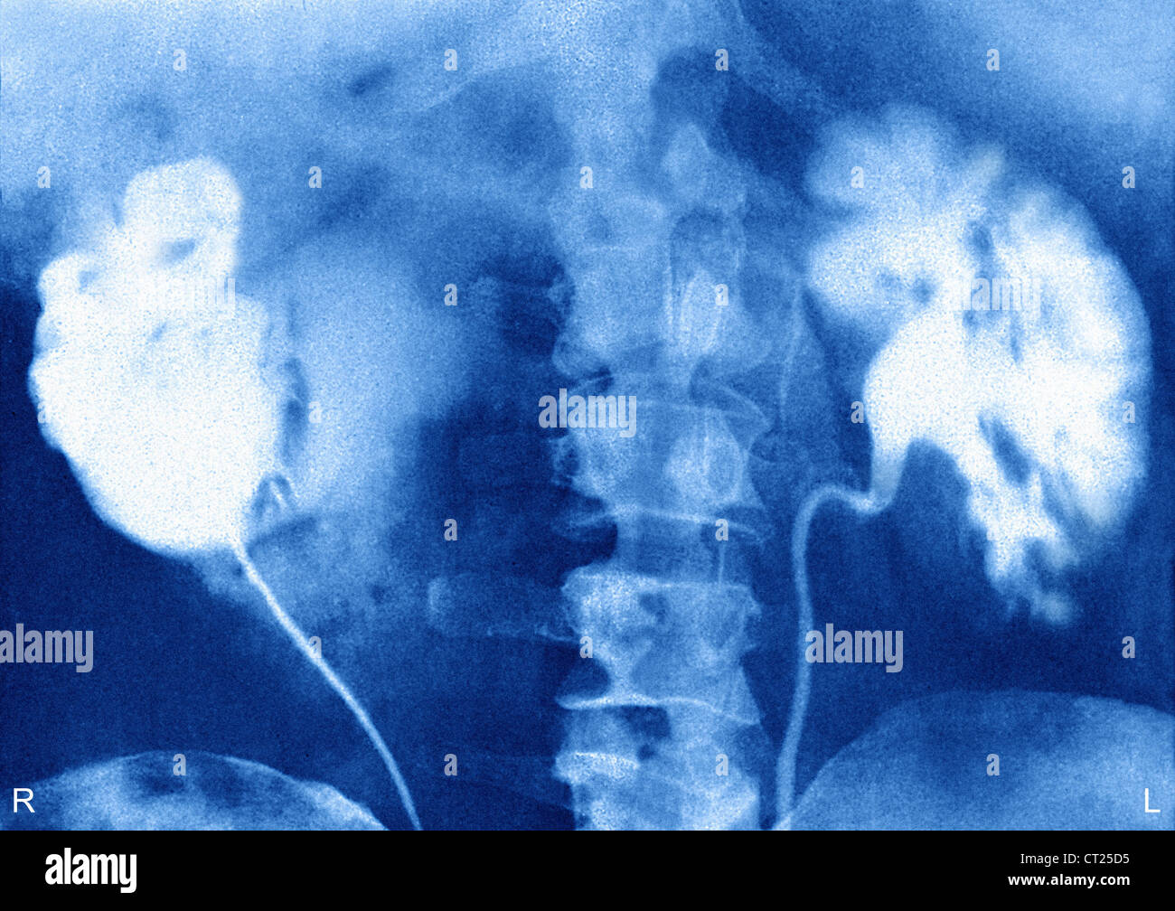 INJURED KIDNEY, X-RAY Stock Photo - Alamy
