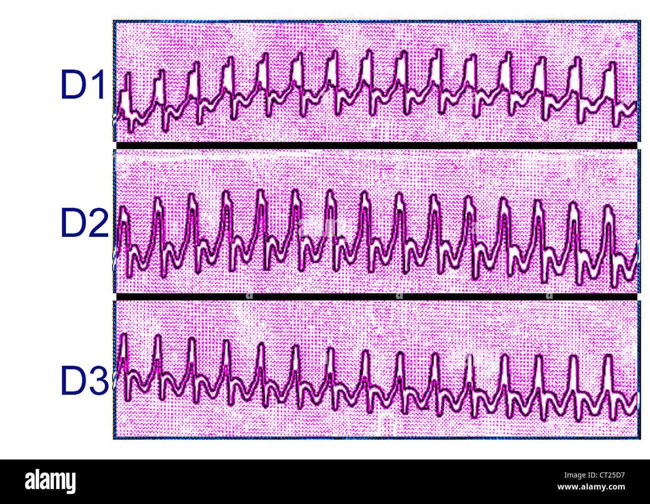 Tachycardia ecg hi-res stock photography and images - Alamy