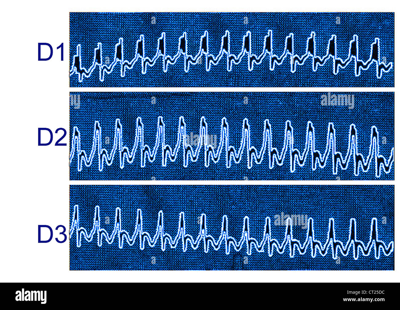 Ventricular tachycardia hi-res stock photography and images - Alamy