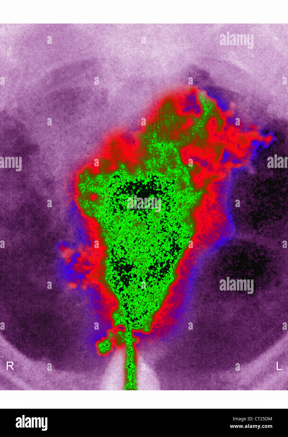 Uterus photos hi-res stock photography and images - Alamy