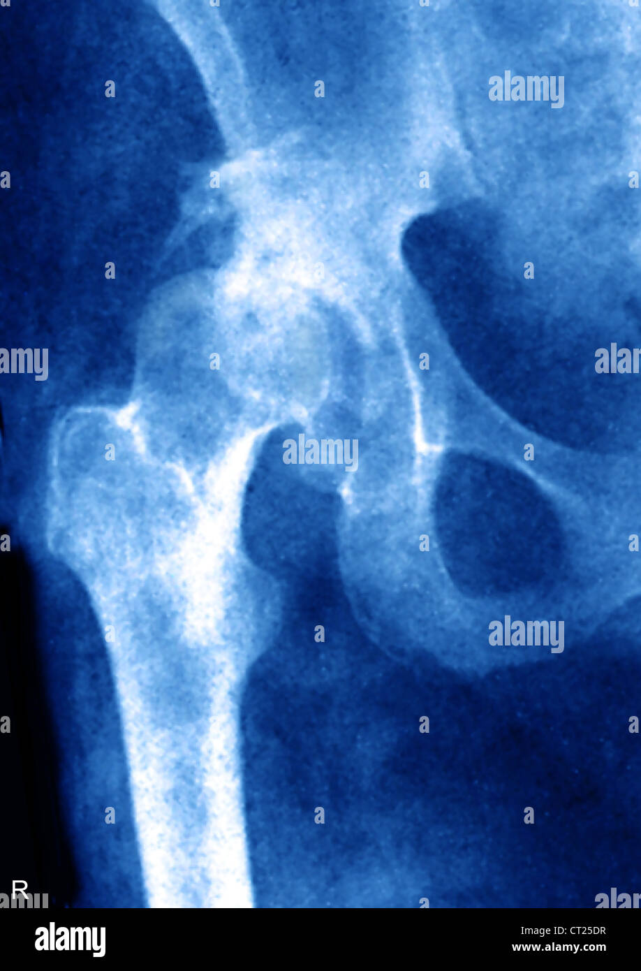 Dislocation Of The Hip High Resolution Stock Photography and Images - Alamy