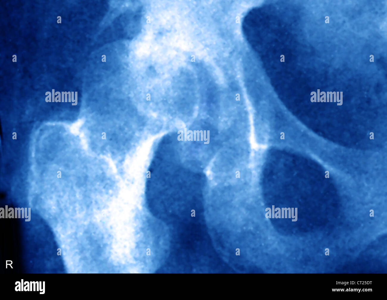 Dislocated hip hi-res stock photography and images - Alamy