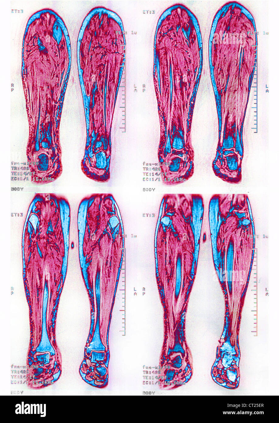 LOWER LIMB, MRI Stock Photo - Alamy