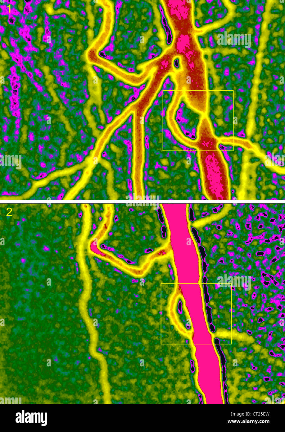 ARTERIAL ANGIOPLASTY, RESULT Stock Photo - Alamy ARTERIAL ANGIOPLASTY, RESULT Stock Photo - Alamy