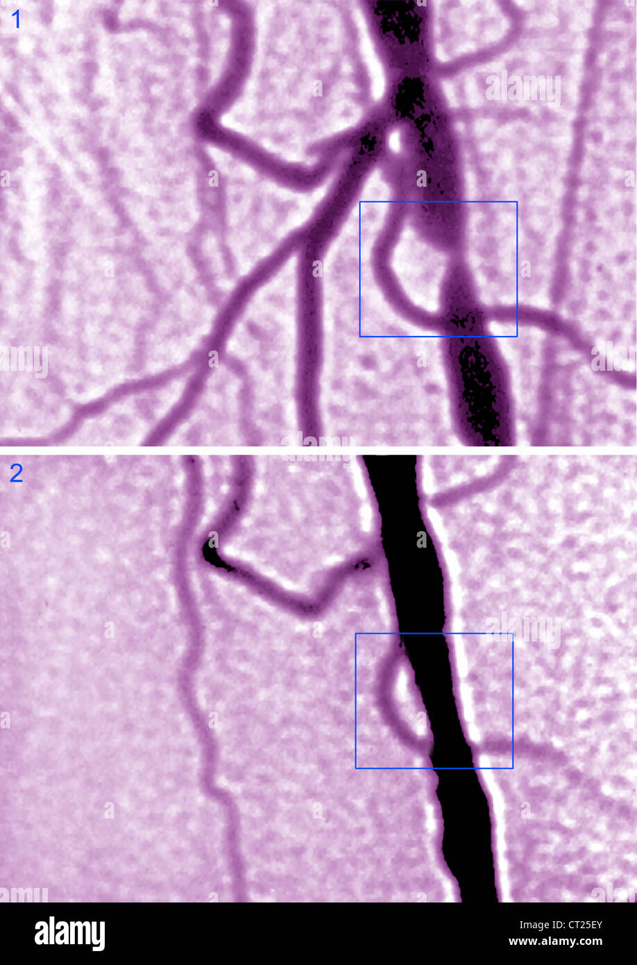 ARTERIAL ANGIOPLASTY, RESULT Stock Photo - Alamy ARTERIAL ANGIOPLASTY, RESULT Stock Photo - Alamy