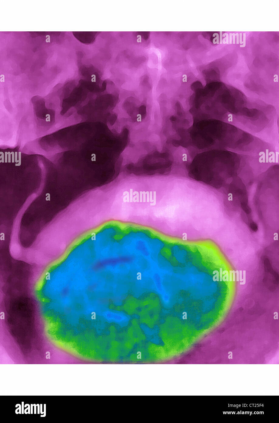 PROSTATIC ADENOMA, X-RAY Stock Photo - Alamy