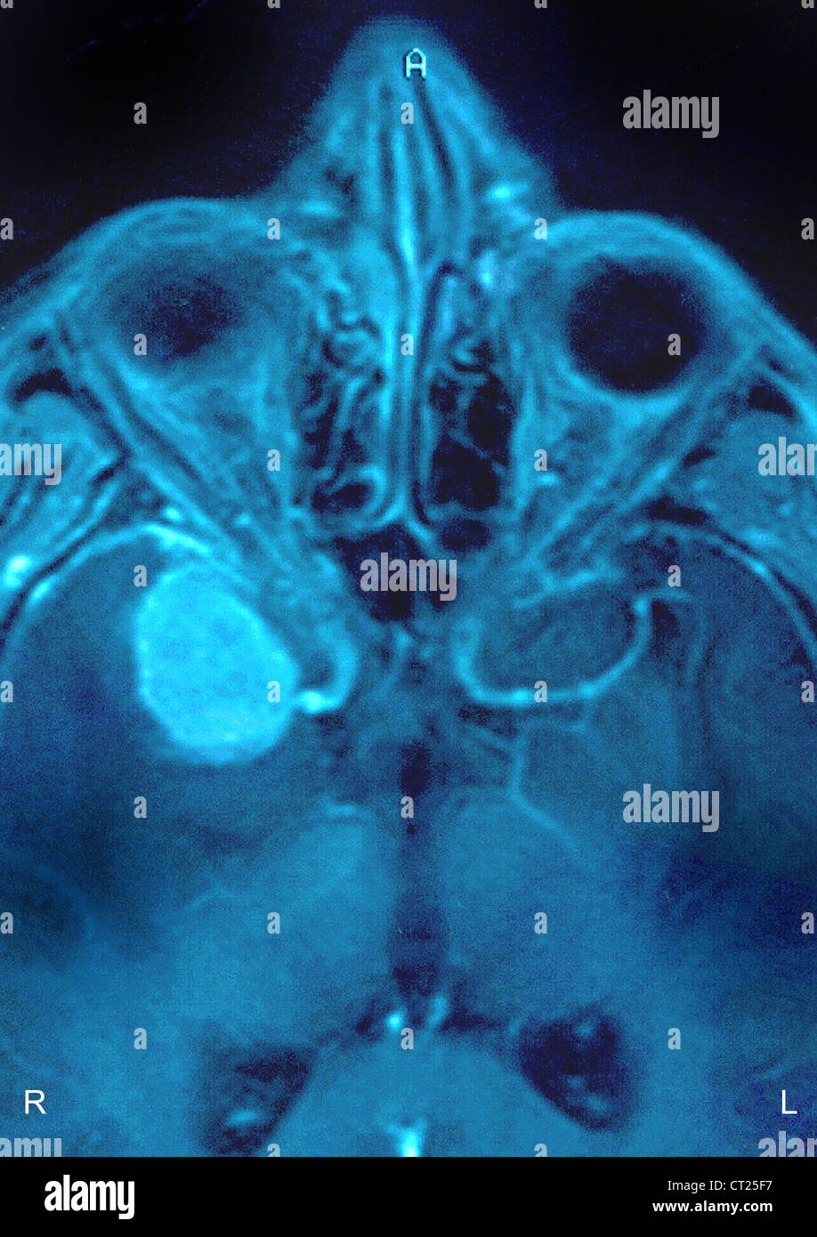 OPTIC NERVE SCHWANNOMA, MRI Stock Photo - Alamy